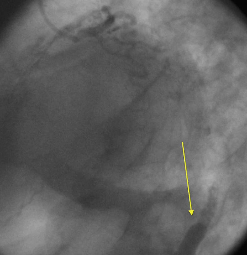 Inferior wall acute myocardial infarction or something else? | Revista ...