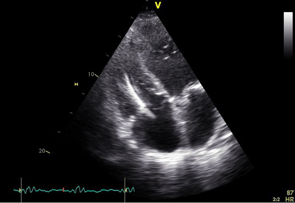 Externalized biventricular implantable cardioverter-defibrillator ...
