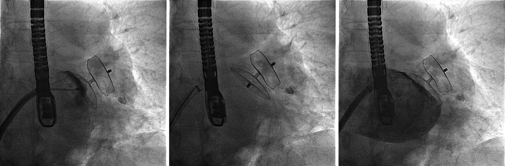 Percutaneous balloon mitral valvuloplasty and closure of the left ...