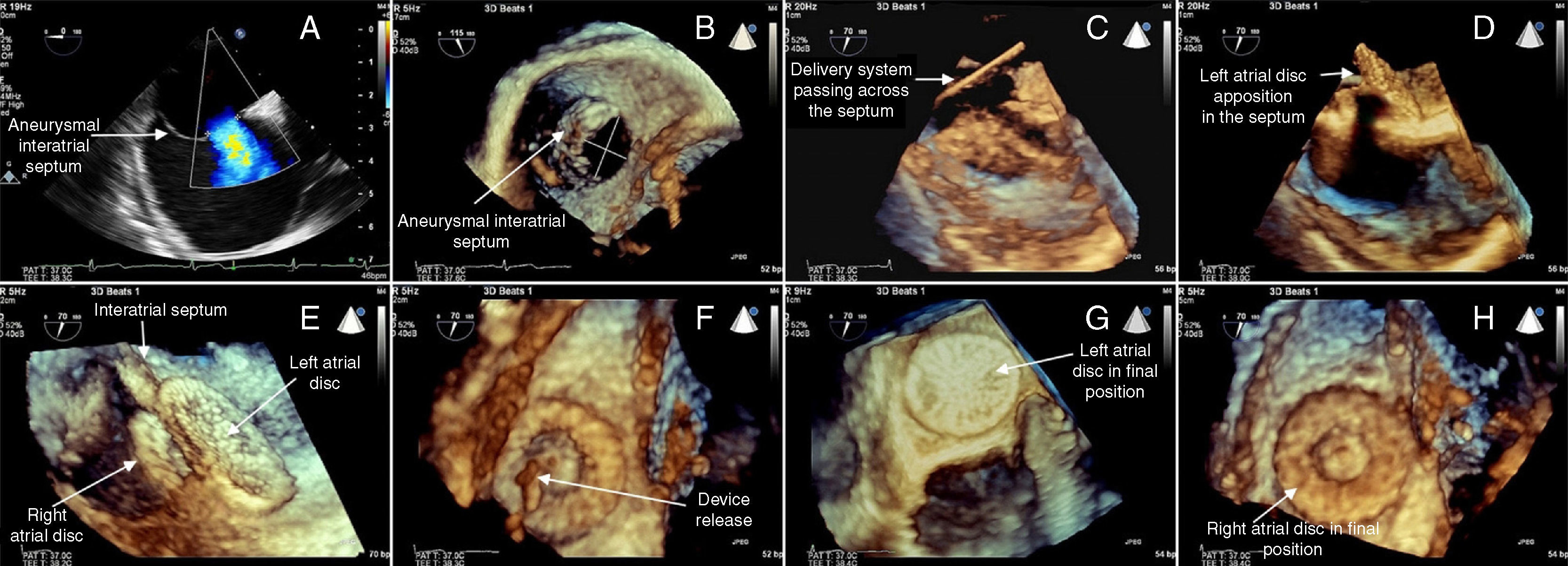 interatrial septum