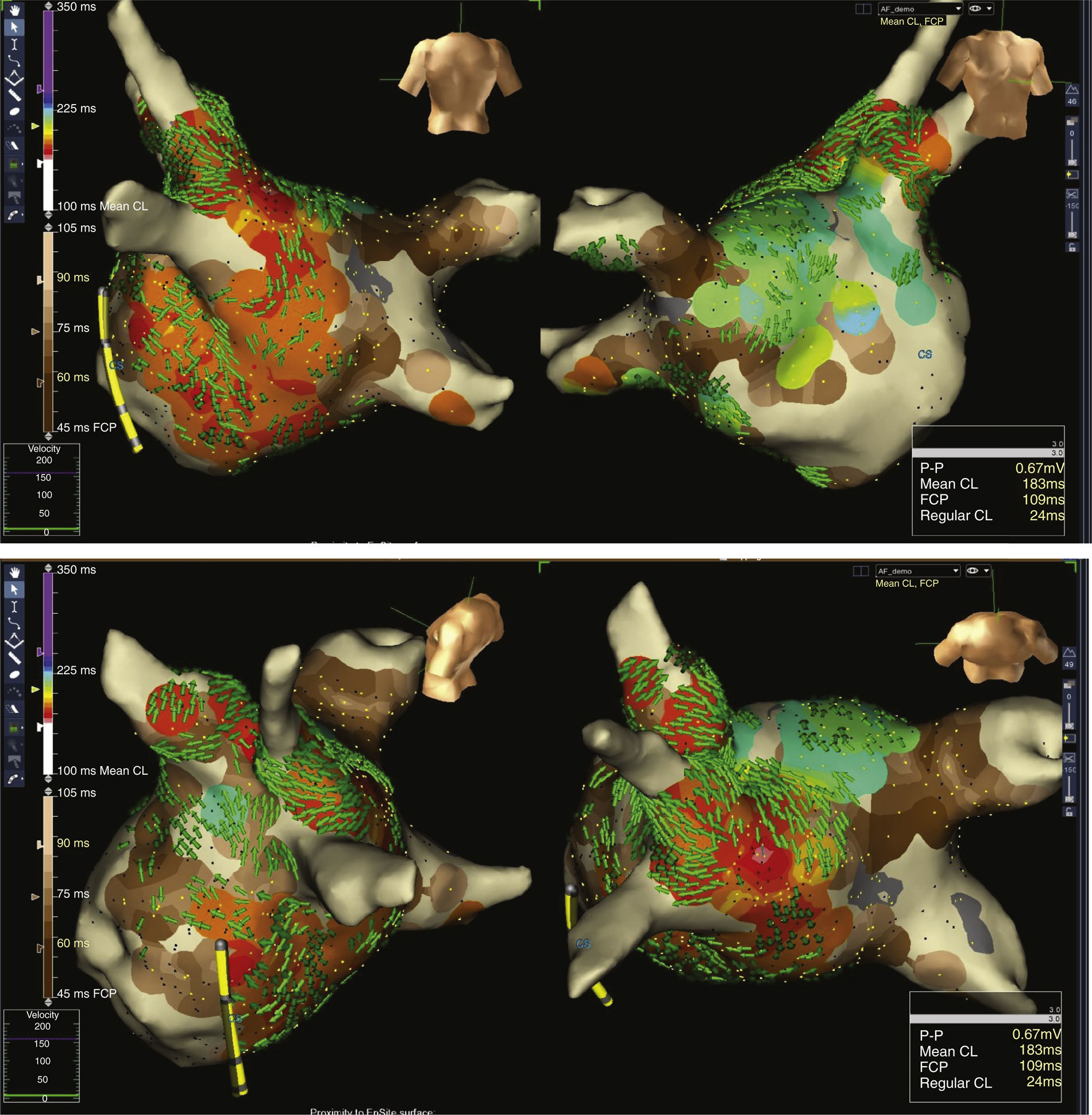 How to map persistent atrial fribillation and increase efficacy of ...