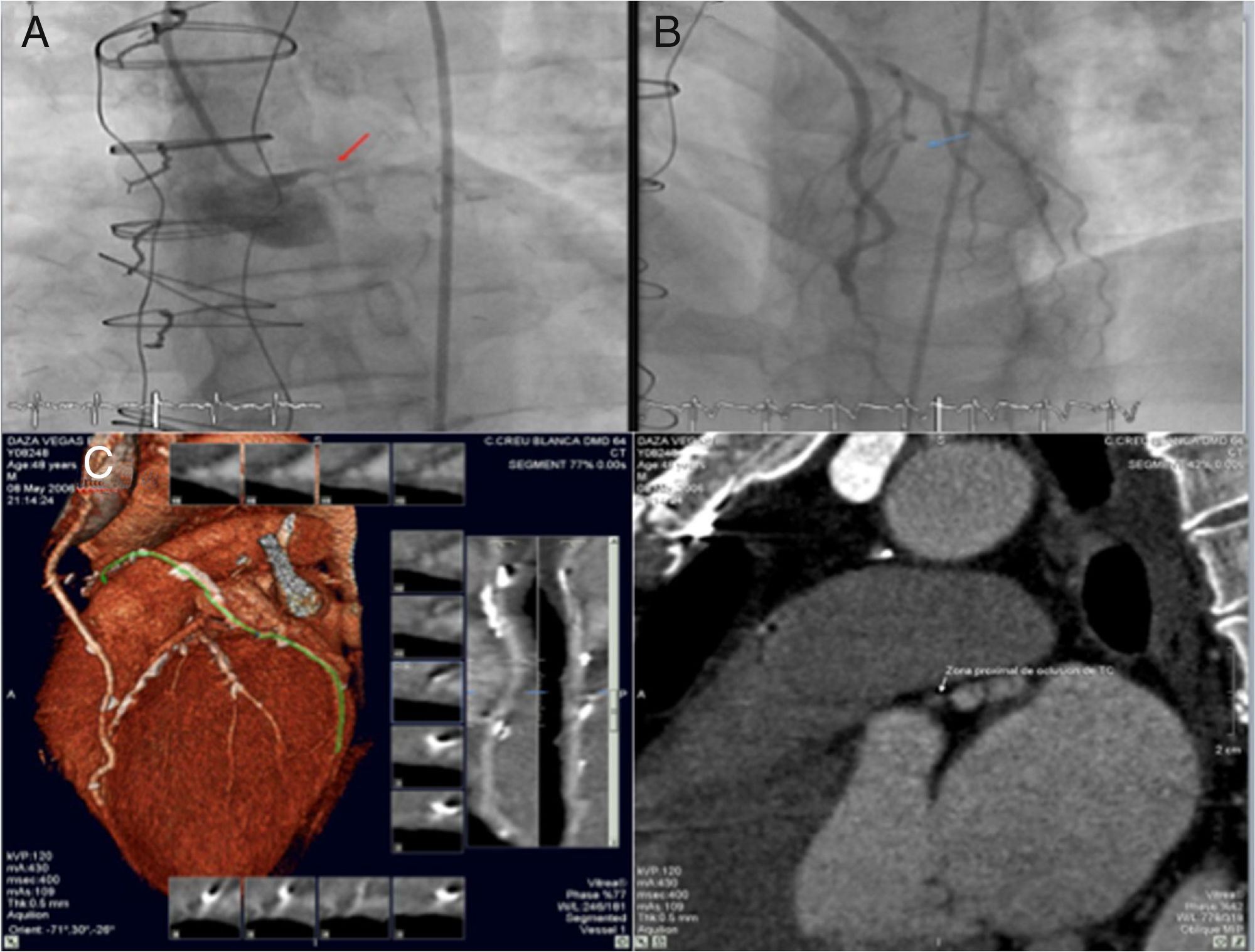 Percutaneous coronary intervention due to chronic total occlusion in ...
