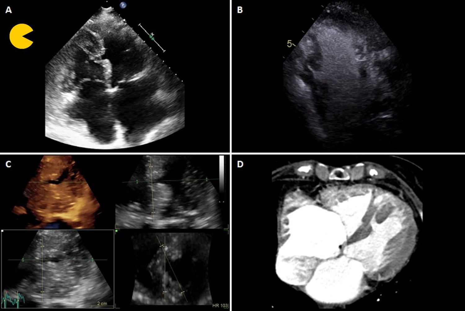 Pacman heart: An unexpected finding | Revista Portuguesa de Cardiologia ...
