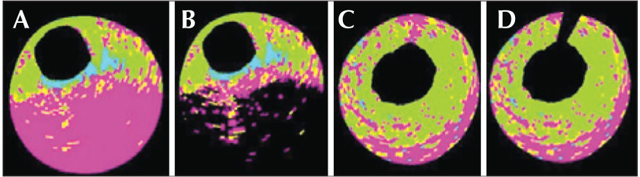 iWONDER (Imaging WhOle vessel coronary tree with intravascular ...
