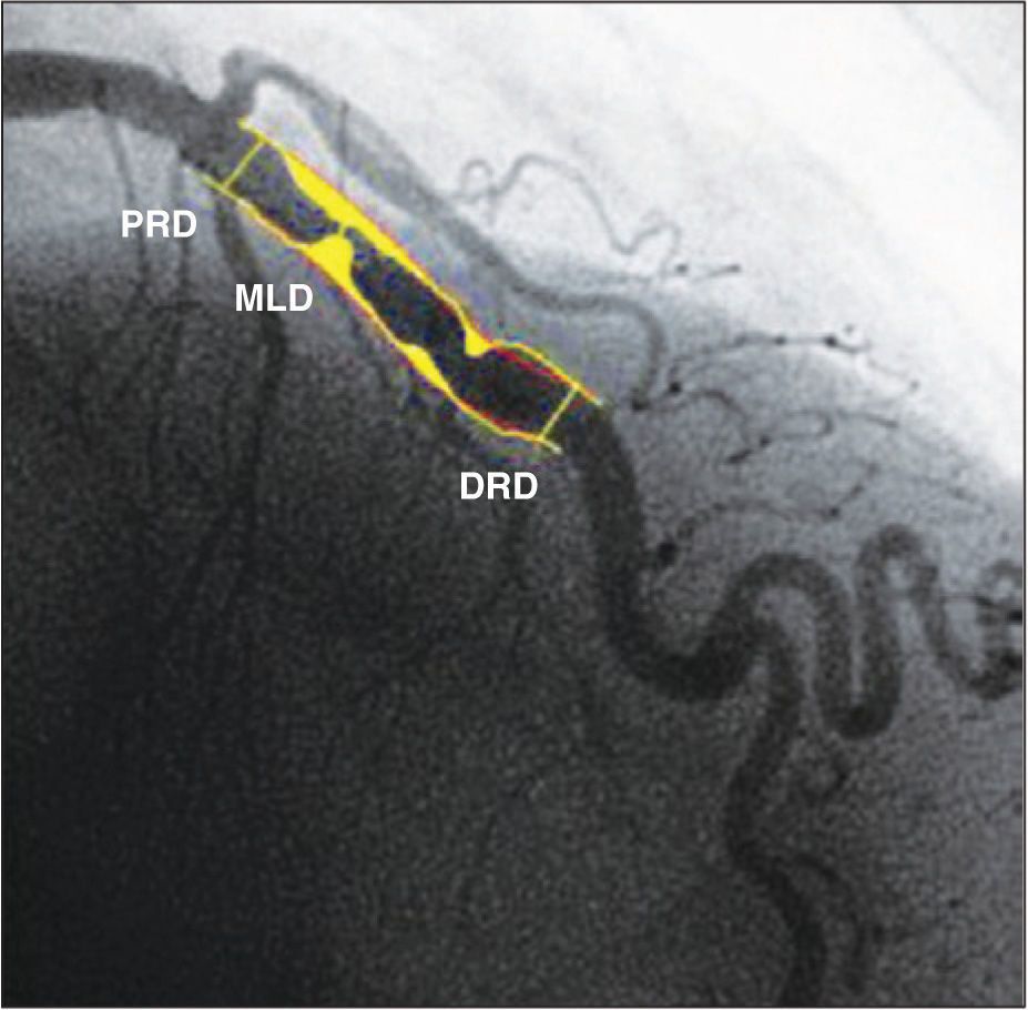 Treatment for Type IV Coronary Perforation during Percutaneous Coronary ...