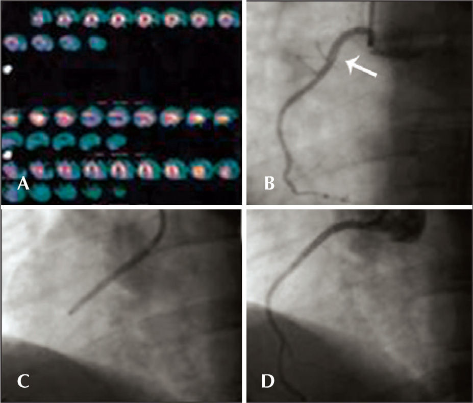 Acute Myocardial Infarction Due to Spontaneous Coronary Artery ...
