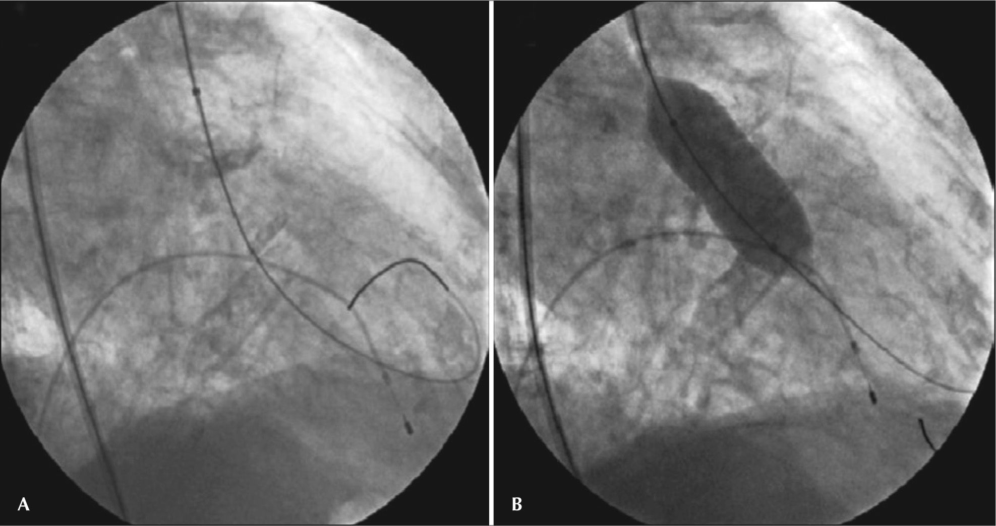 Emergency Percutaneous Balloon Aortic Valvuloplasty in Critical Aortic ...
