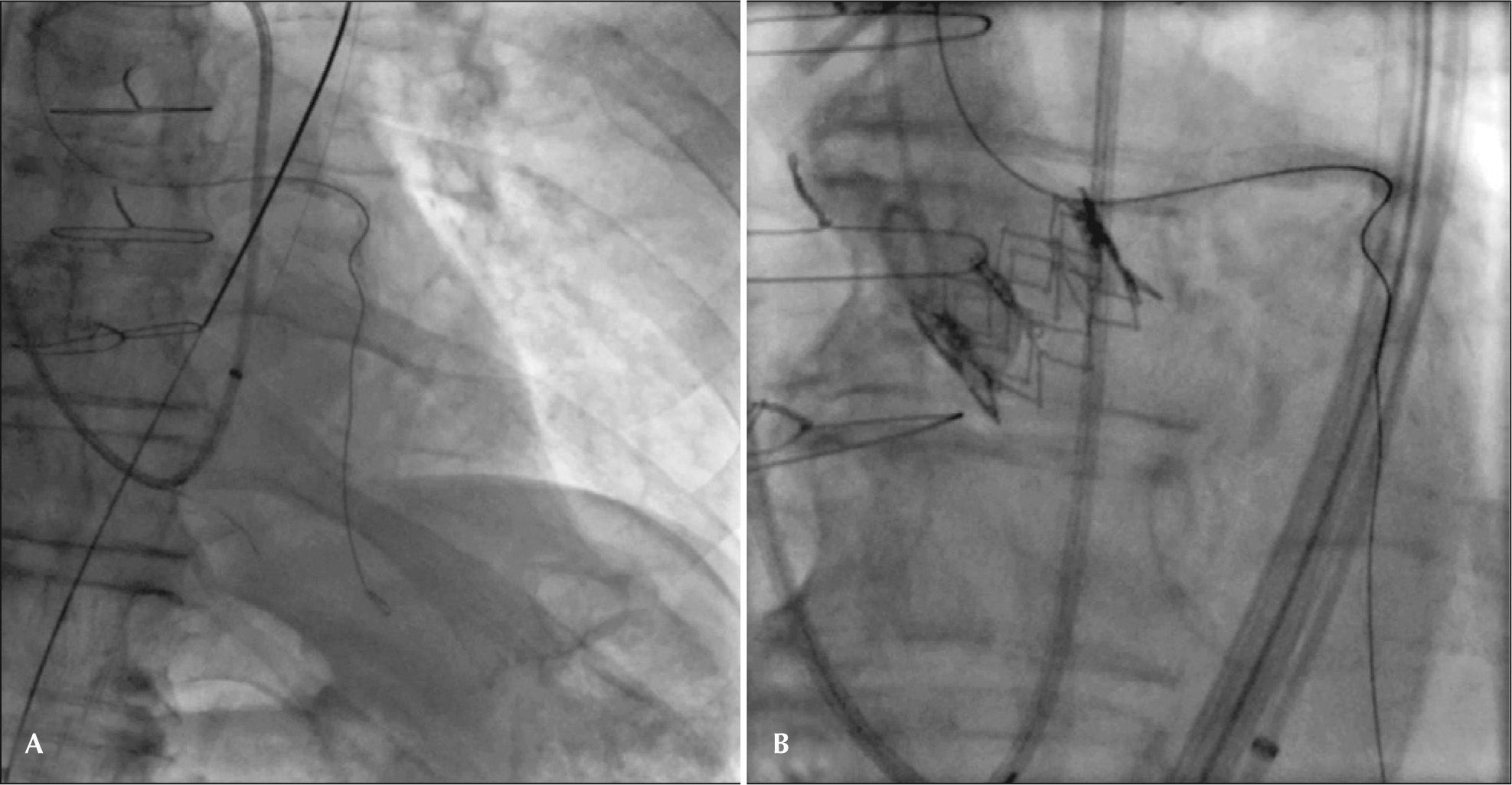 Coronary Obstruction Following Transcatheter Aortic Valve Implantation ...