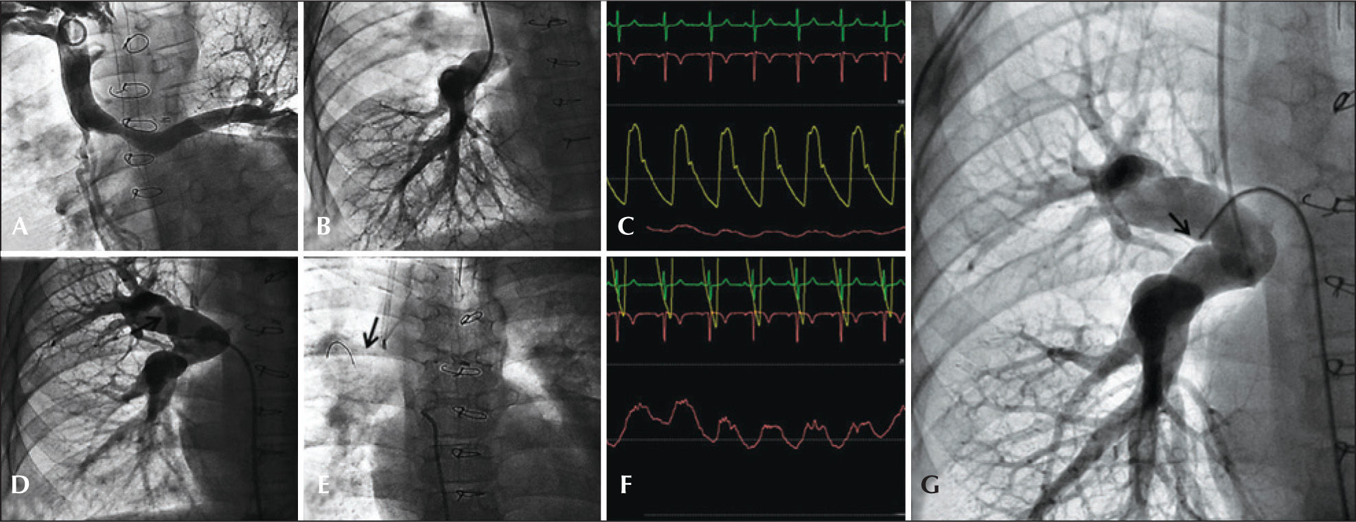 Use of the Miniature Pressure-Wire Manometric System in Congenital and ...