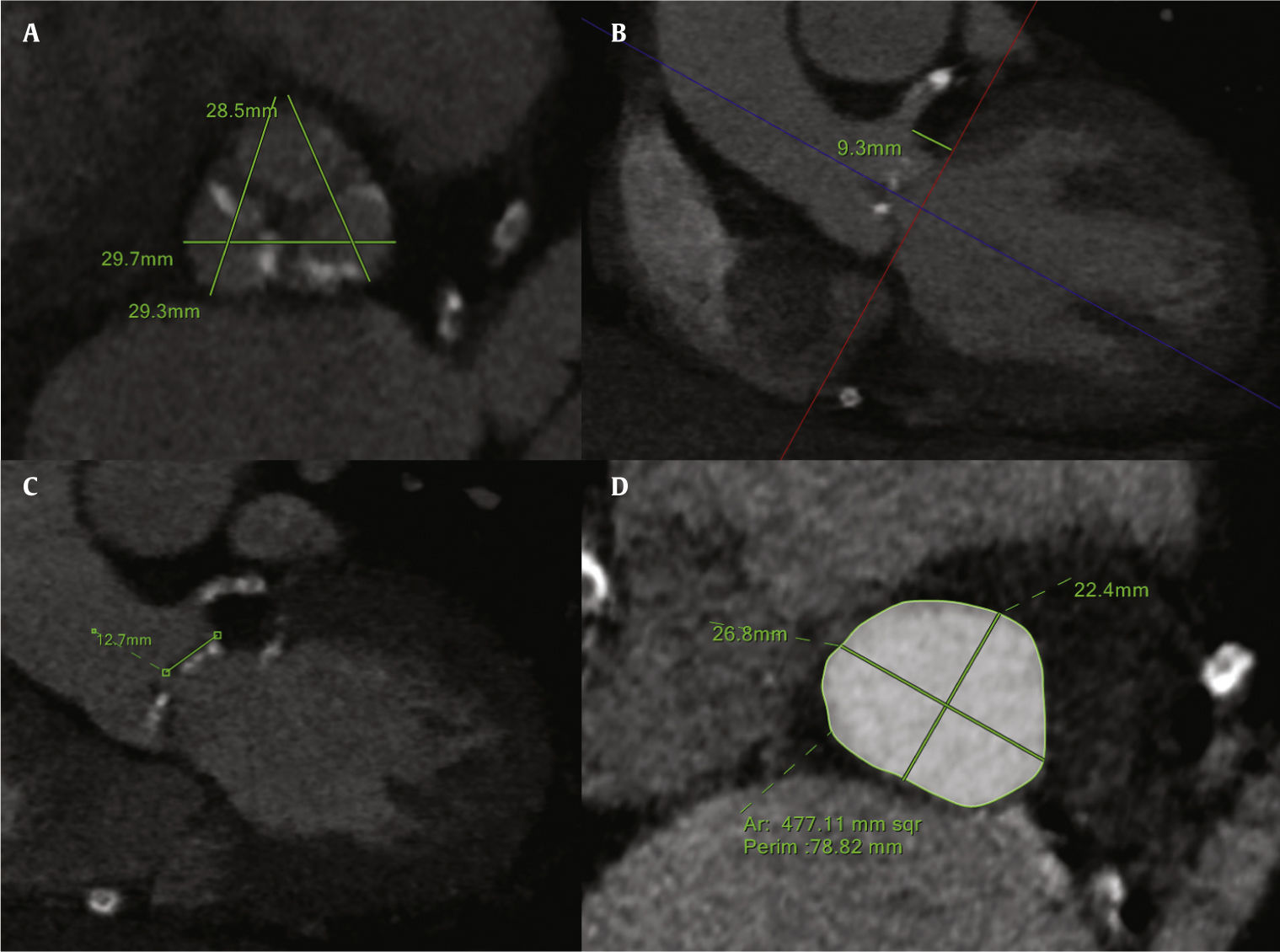 Post-TAVR coronary obstruction | Revista Brasileira de Cardiologia ...