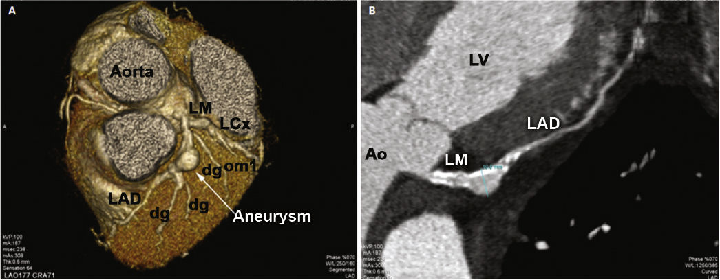left circumflex artery dissection