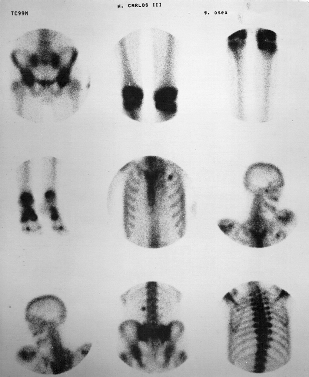 Utilidad de la gammagrafía ósea en el diagnóstico de osteomalacia ...