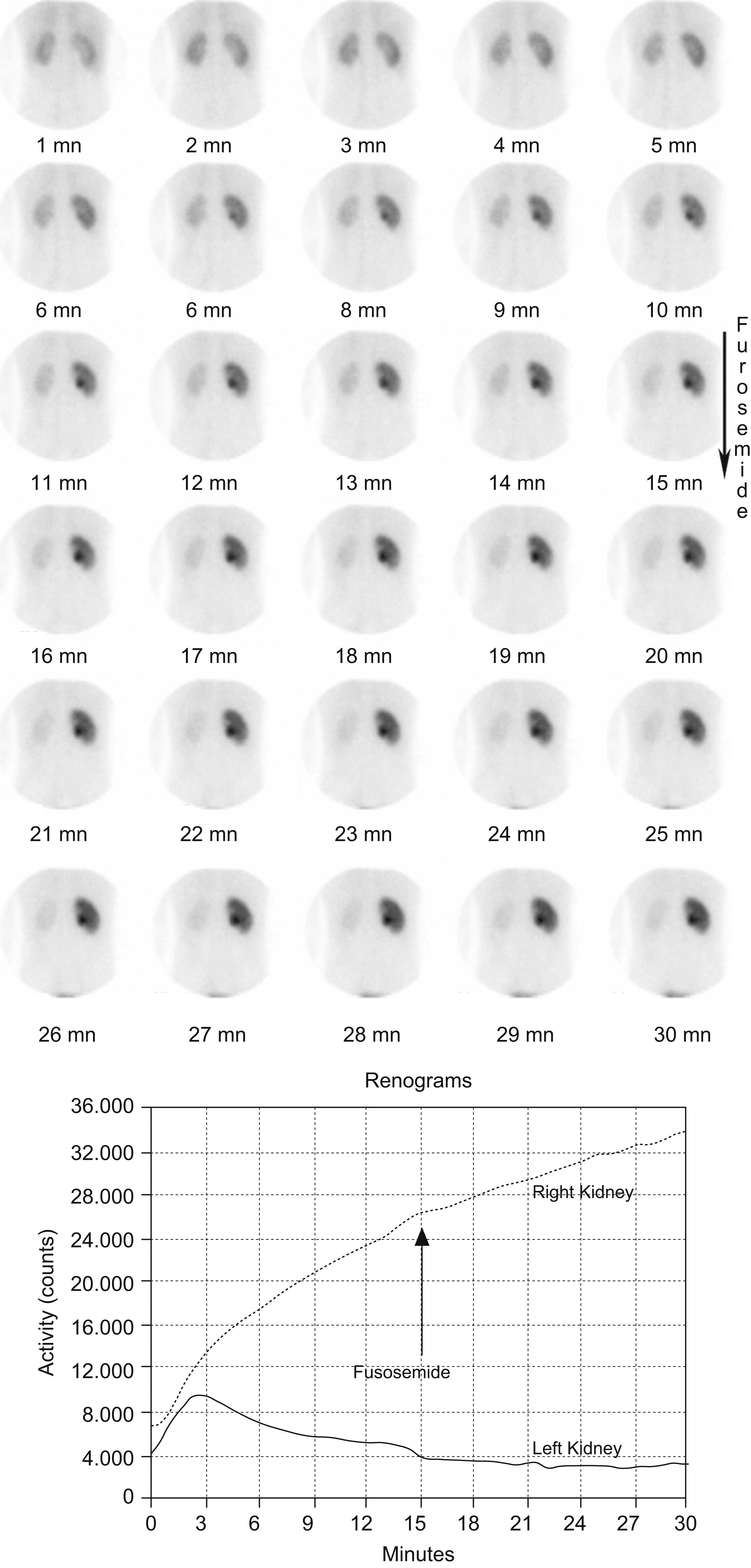 Captopril renography as a prognostic factor in obstructive ...