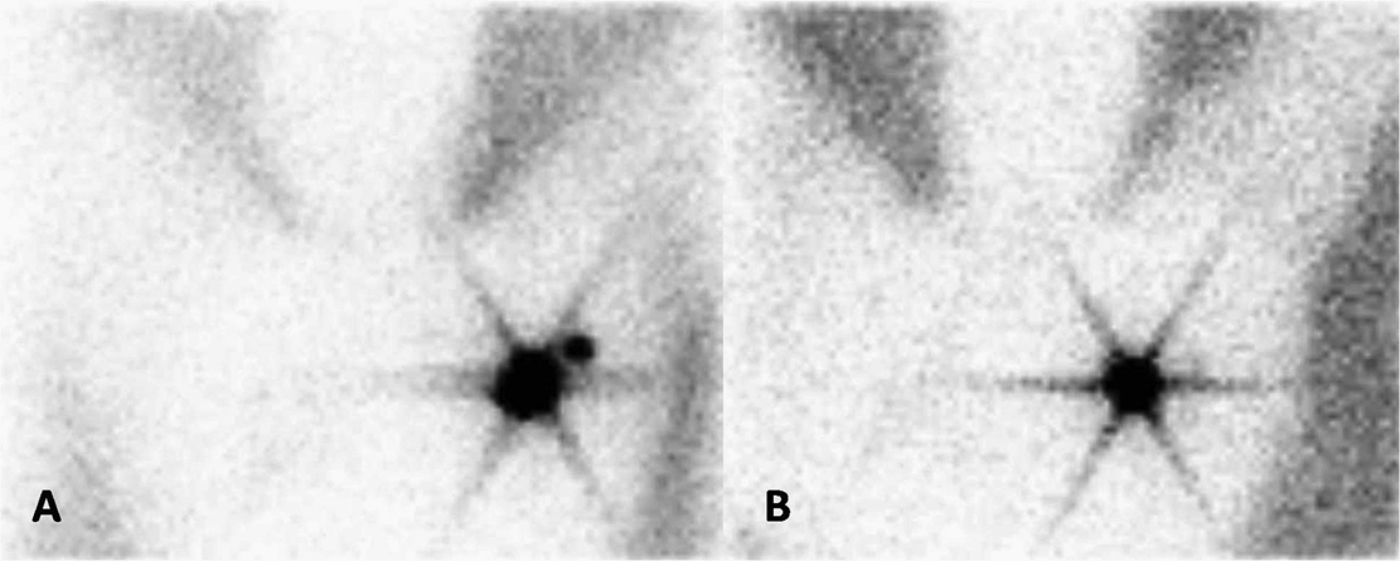 Factors affecting sentinel lymph node detection failure in breast ...