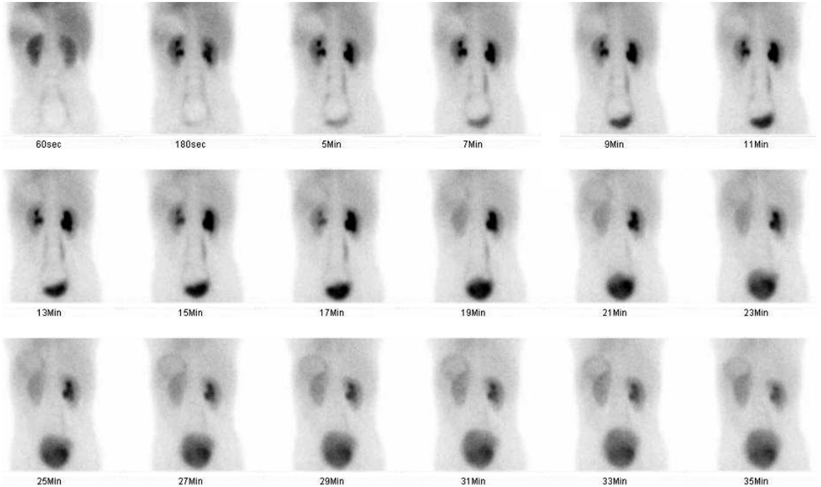Ring sign over left kidney in 99mTc DTPA renal scintigraphy | Revista ...