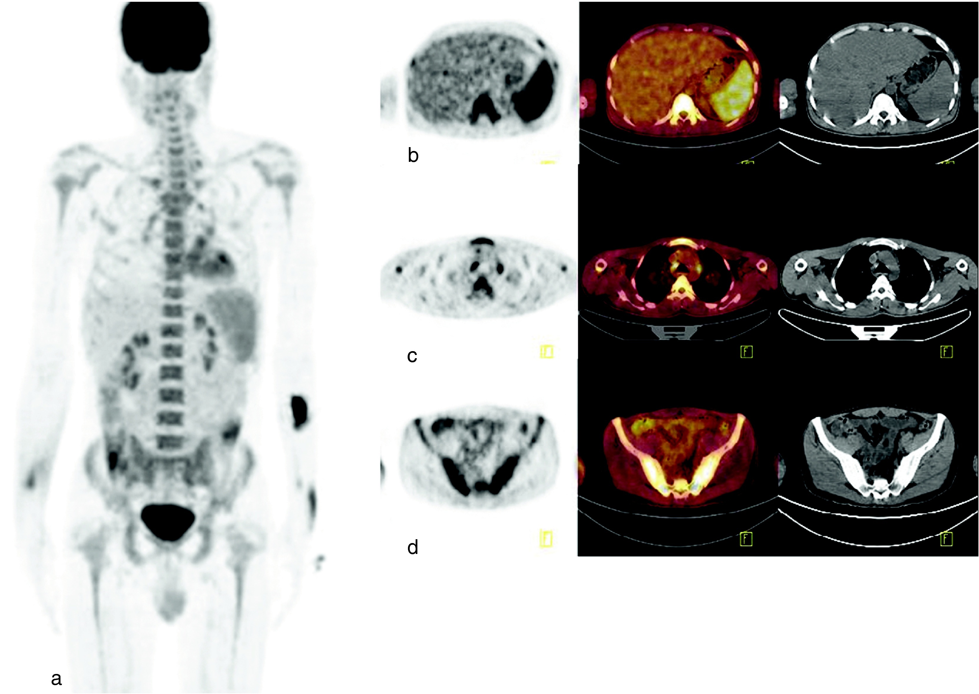 Acute myeloid leukemia detected on fluorine- 18 fluorodeoxyglucose ...