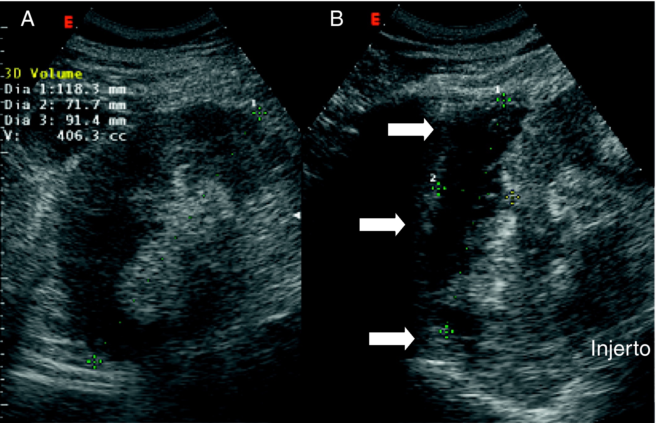 Hematoma versus urinoma. Un dilema diagnóstico del renograma 99mTc-MAG3 ...
