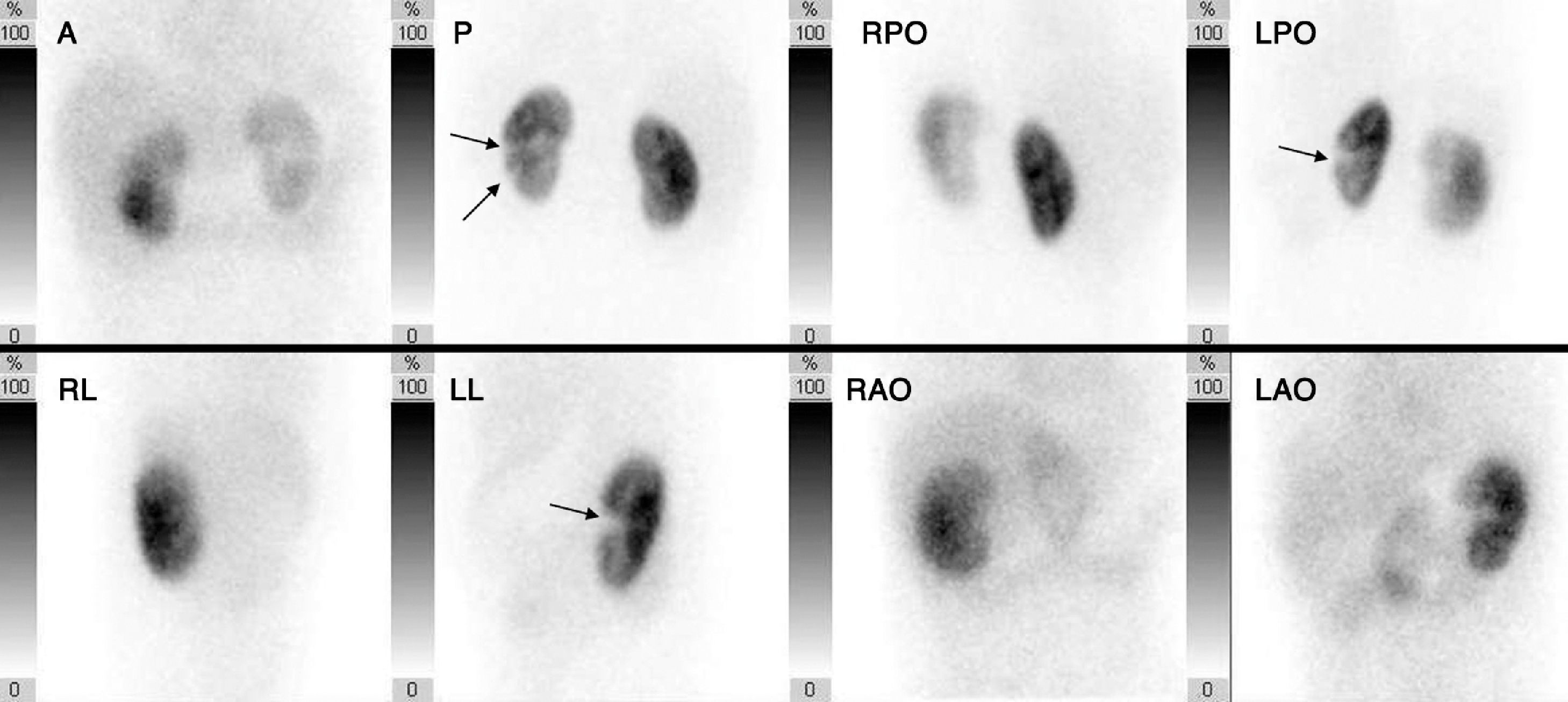 Monitoring of renal function using 99mTc-DMSA and 99mTc-DTPA ...
