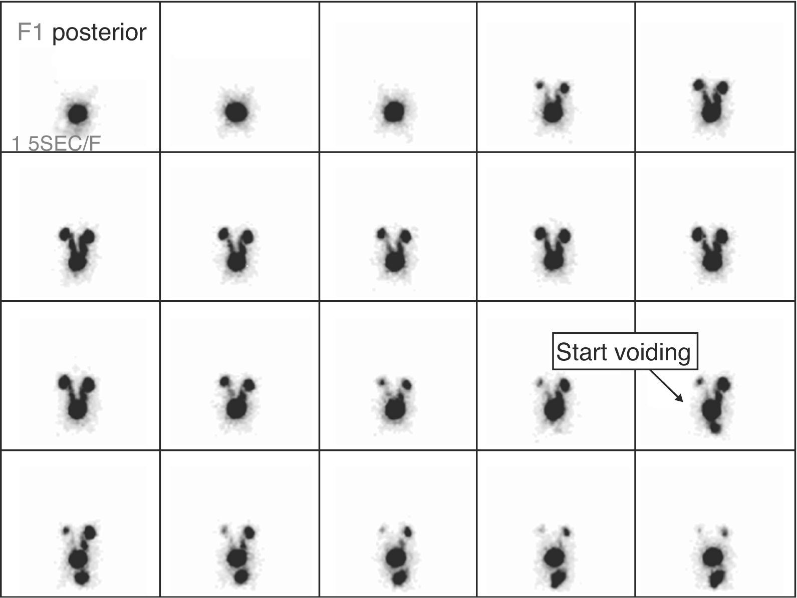Predict the spontaneous resolution of vesicoureteral reflux by direct ...
