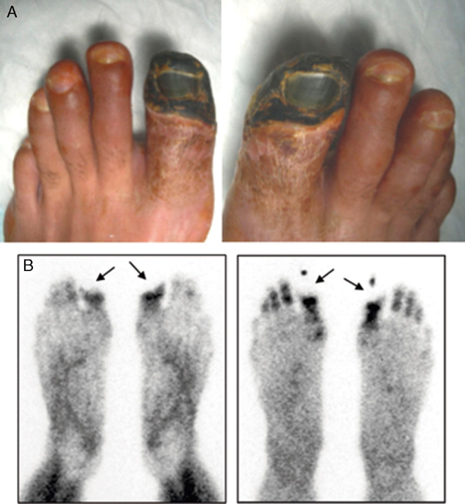 The role of bone scanning in severe frostbite of the feet in a ...