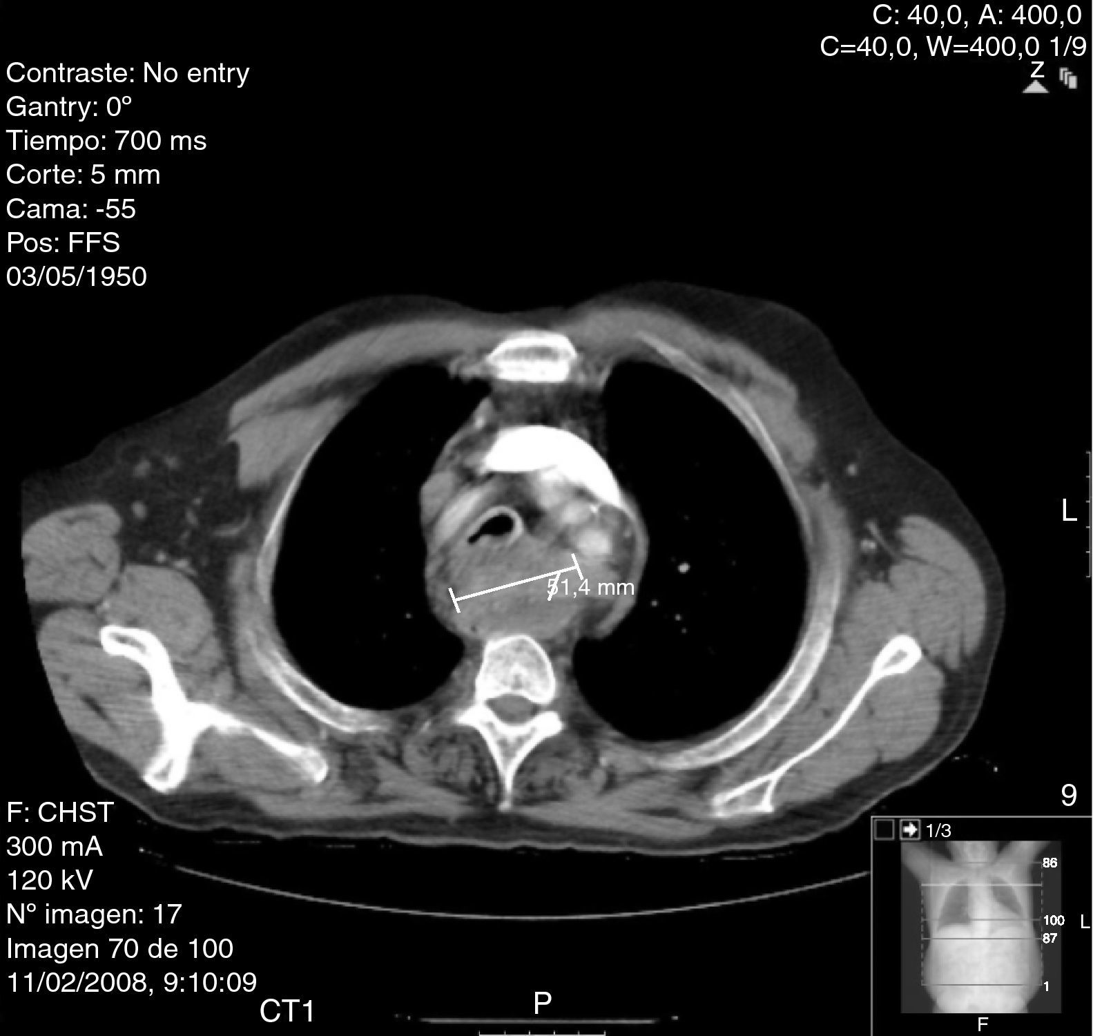 Aportación diagnóstica de la gammagrafía pulmonar de V/Q en un caso de ...