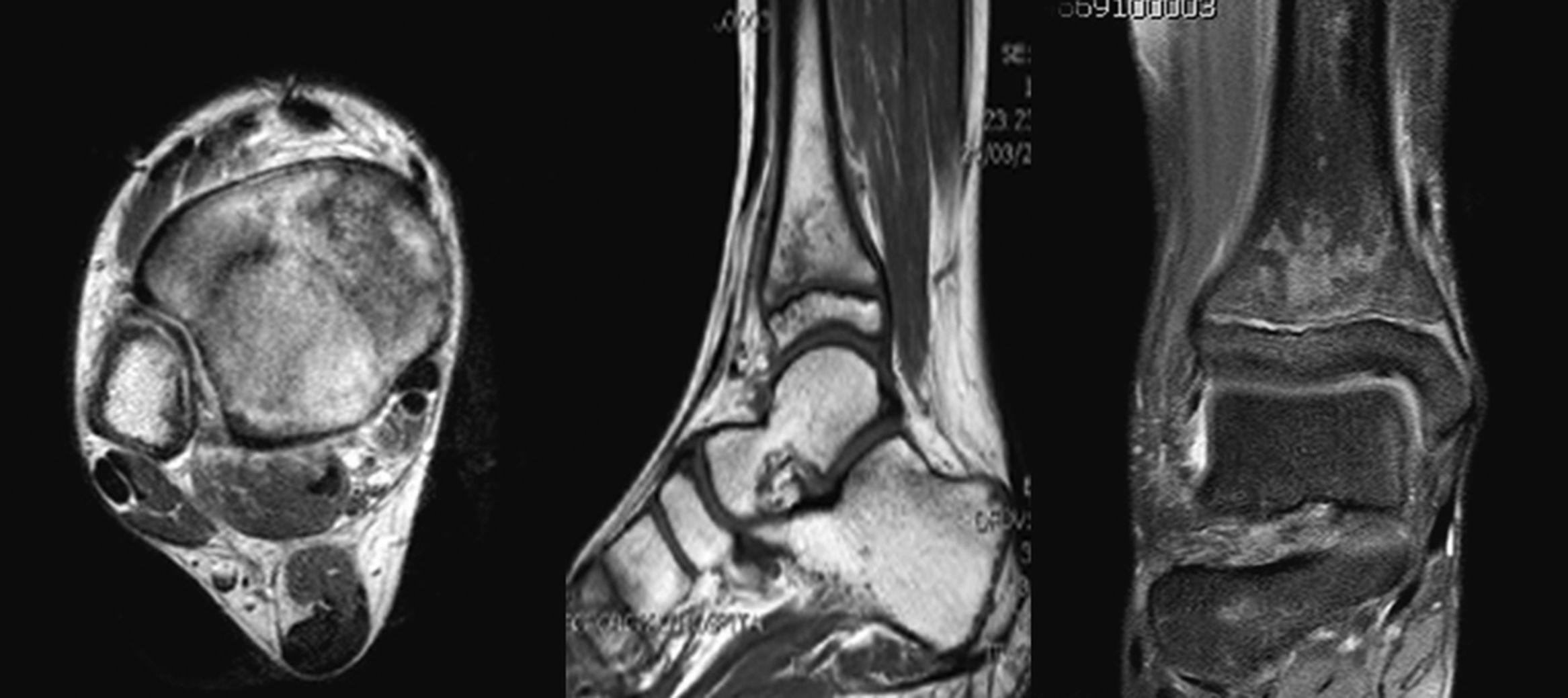 Discordance between MRI and bone scan findings in a child with acute ...