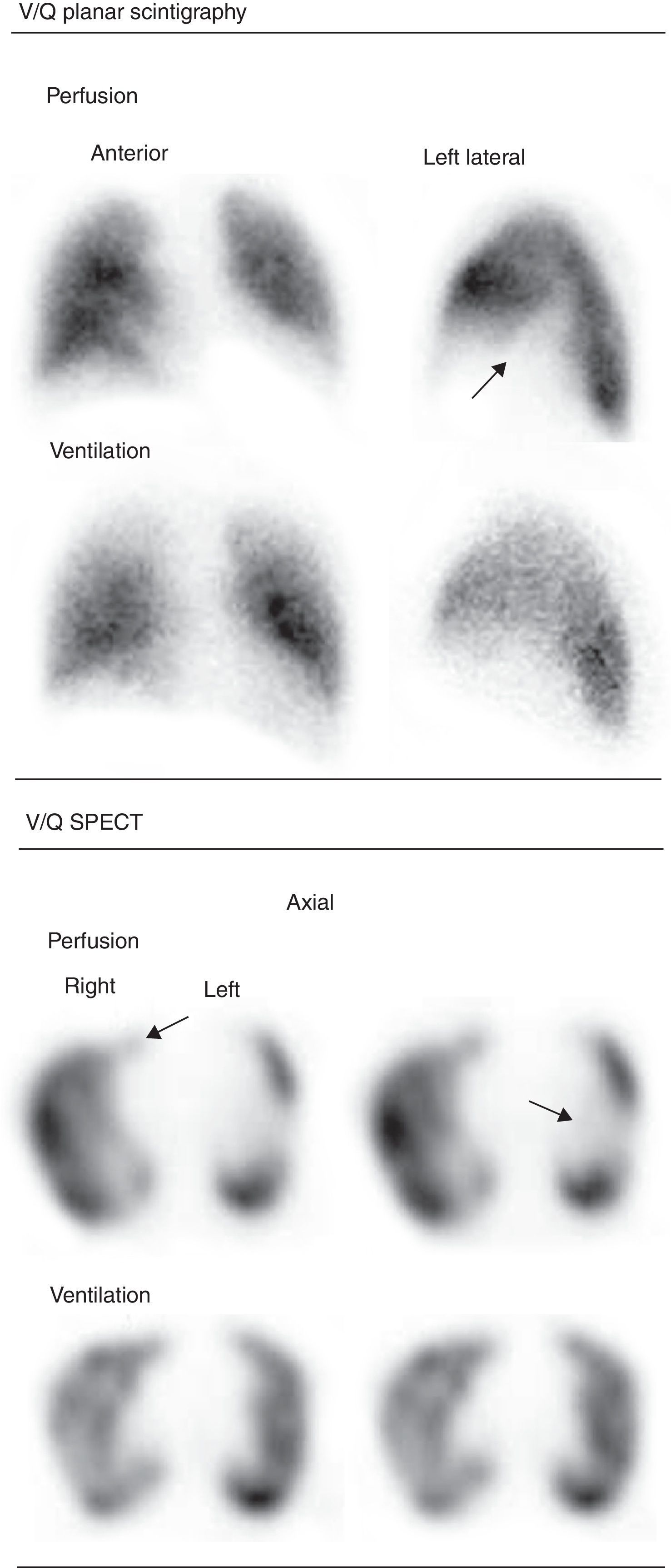 Contribution of V/Q SPECT to planar scintigraphy in the diagnosis of ...