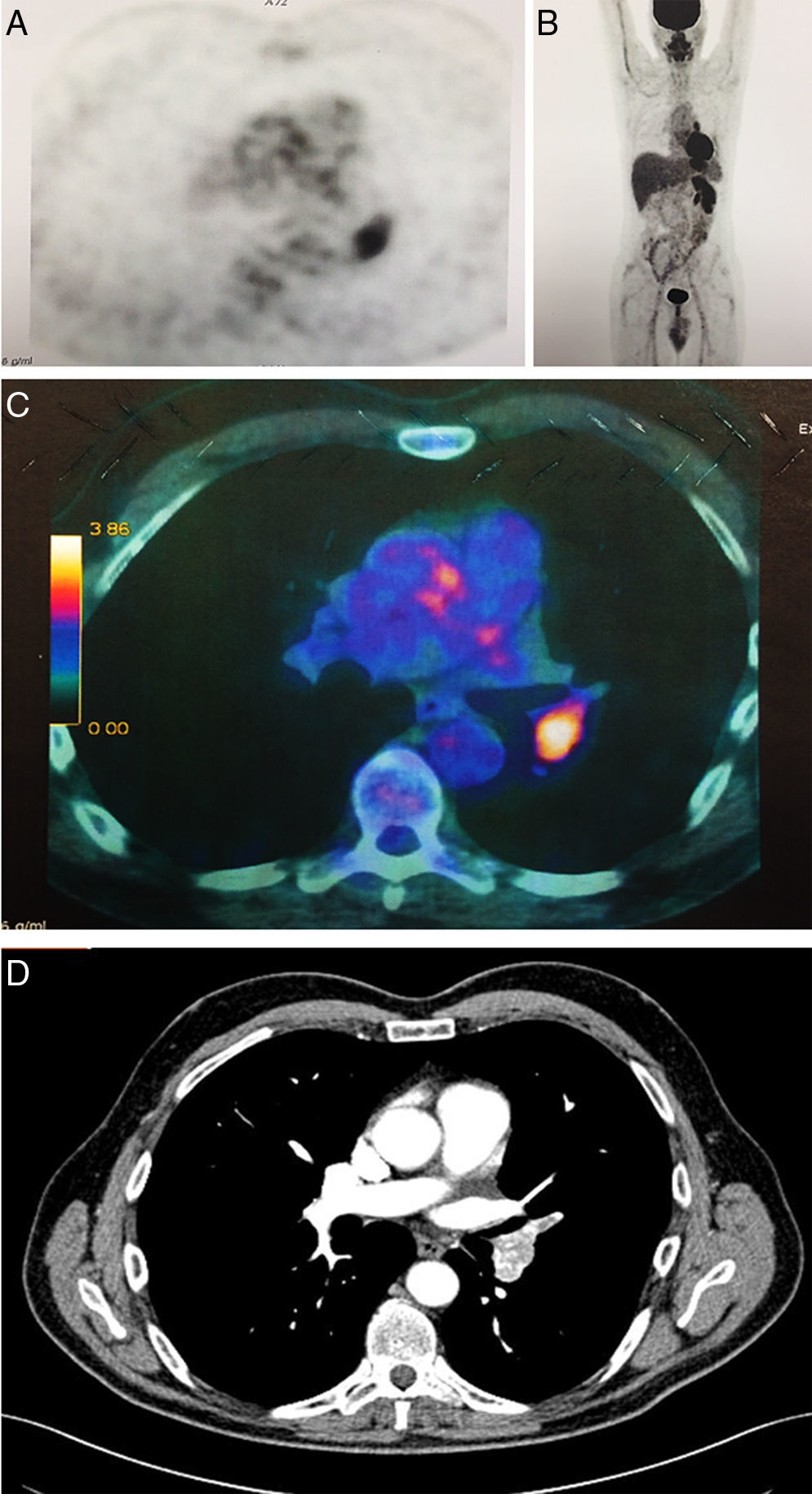 Pulmonary tumor embolus with high 18FDG uptake mimicking lung ...