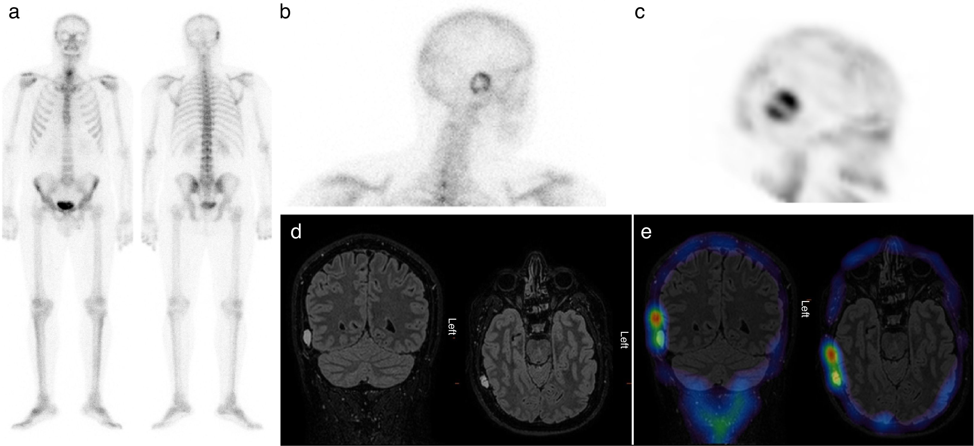 99mTc-HDP SPECT/MRI in isolated xanthoma of the temporal bone | Revista ...