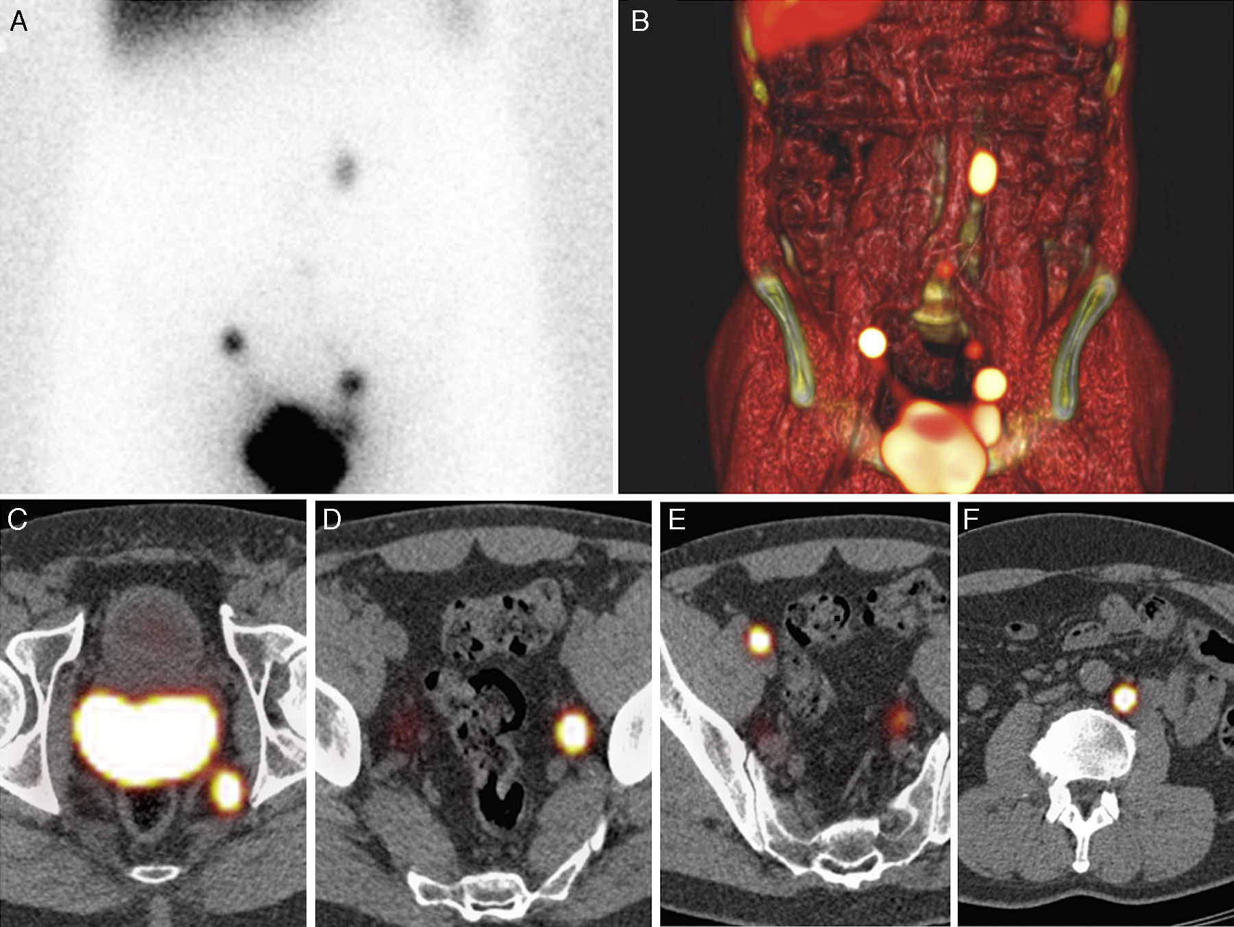 Sentinel node approach in prostate cancer | Revista Española de ...