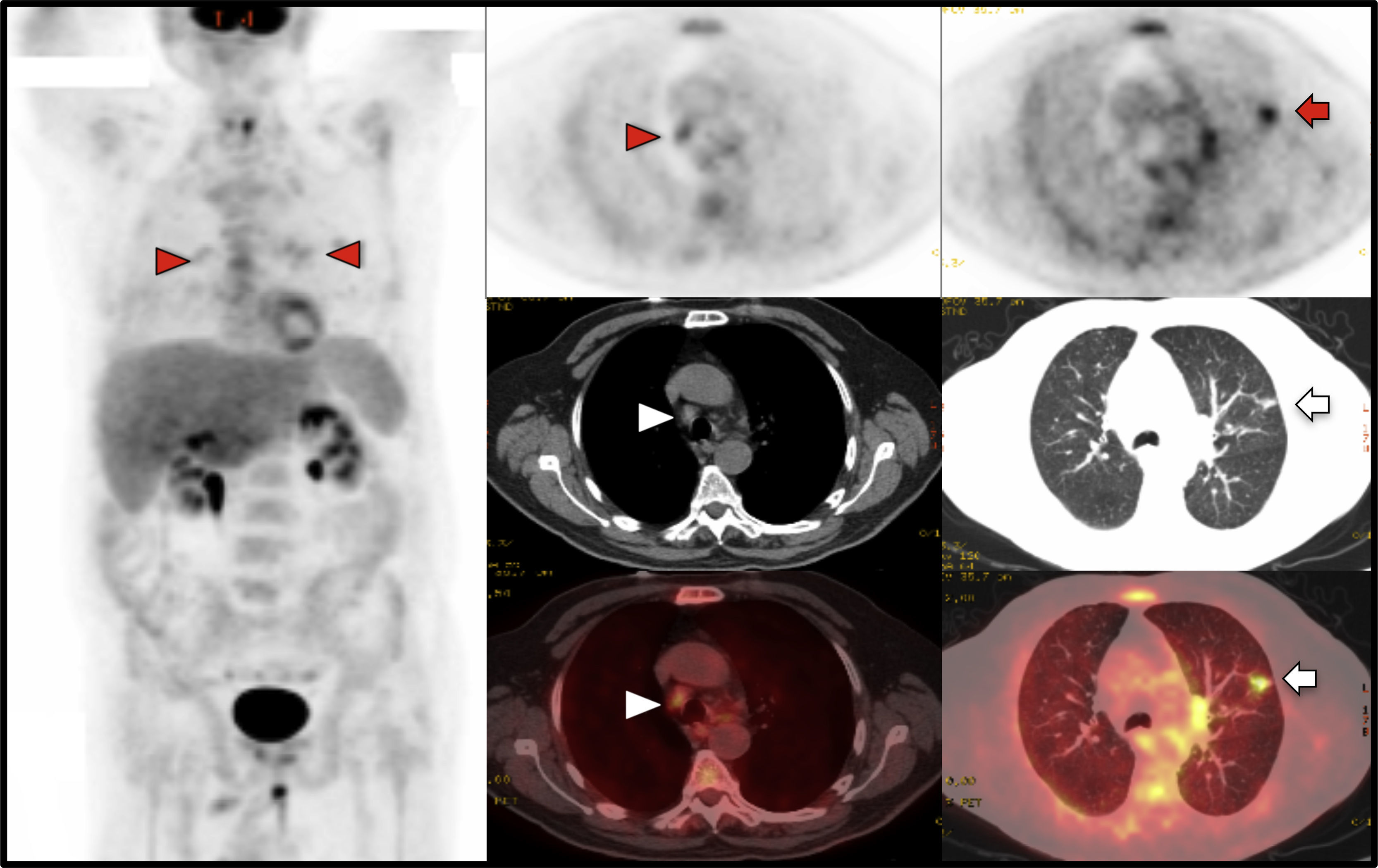 BCGitis detected by 18F-FDG PET/CT after treatment of bladder ...