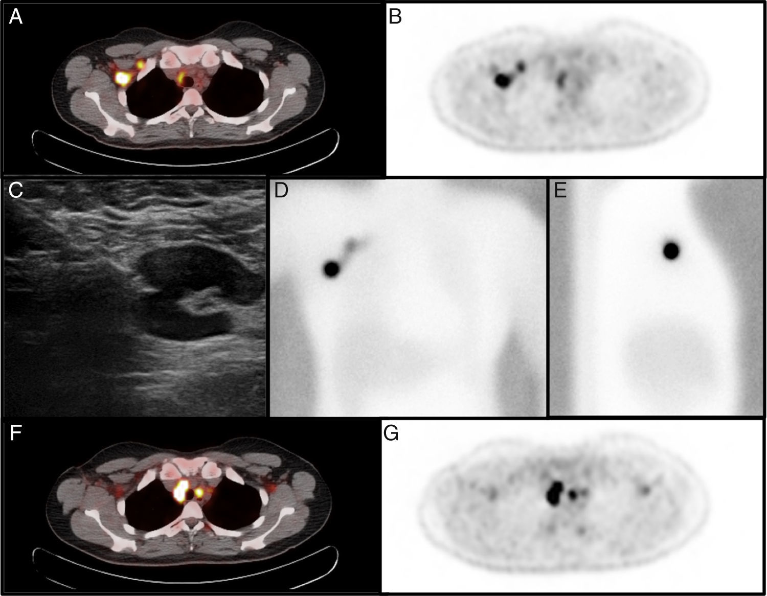 Hybrid radioguided occult lesion localization (hybrid ROLL) of 18F-FDG ...