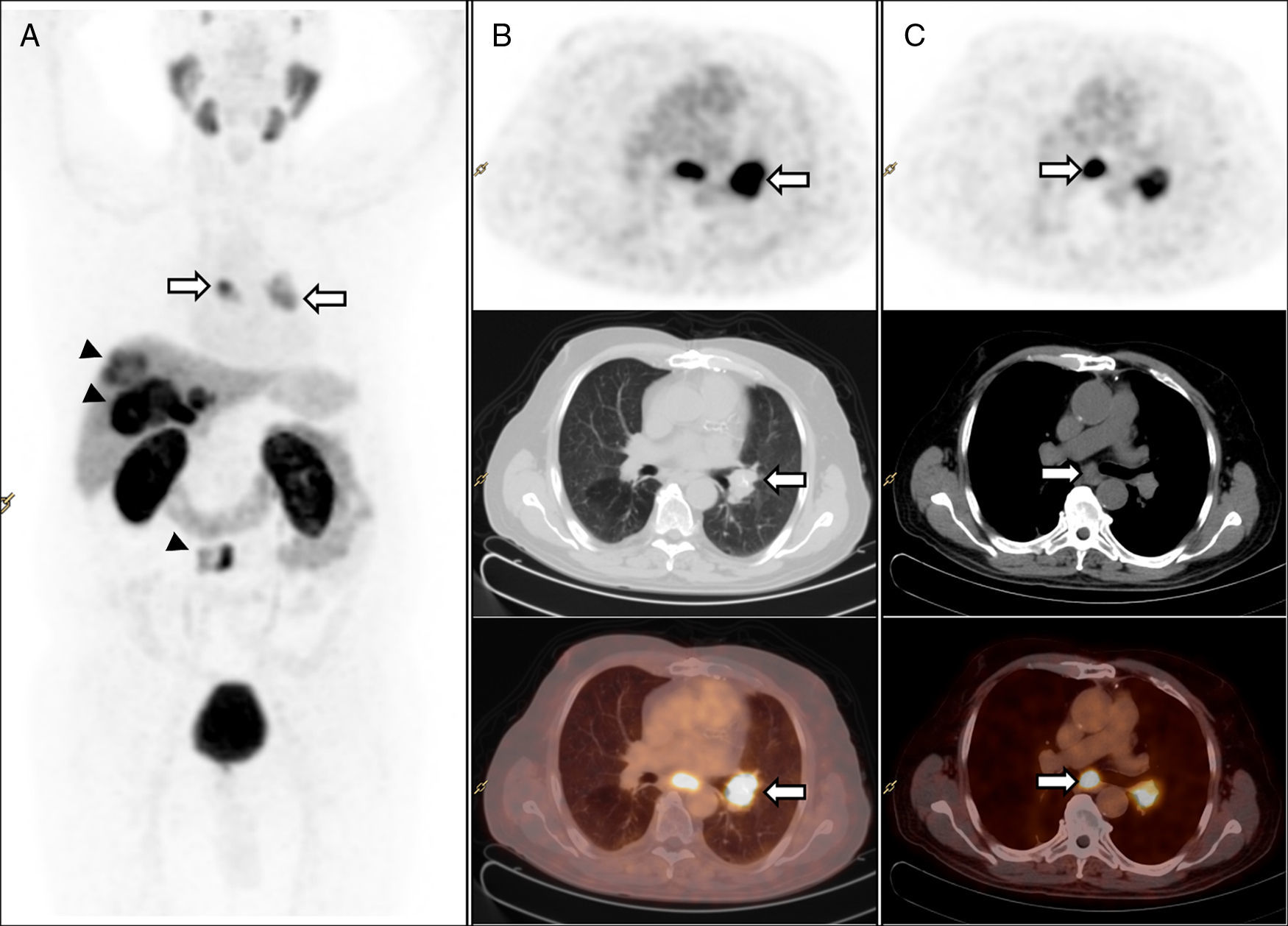 A potential pitfall in the use of 68Ga-PSMA PET/CT: Anthracosis ...