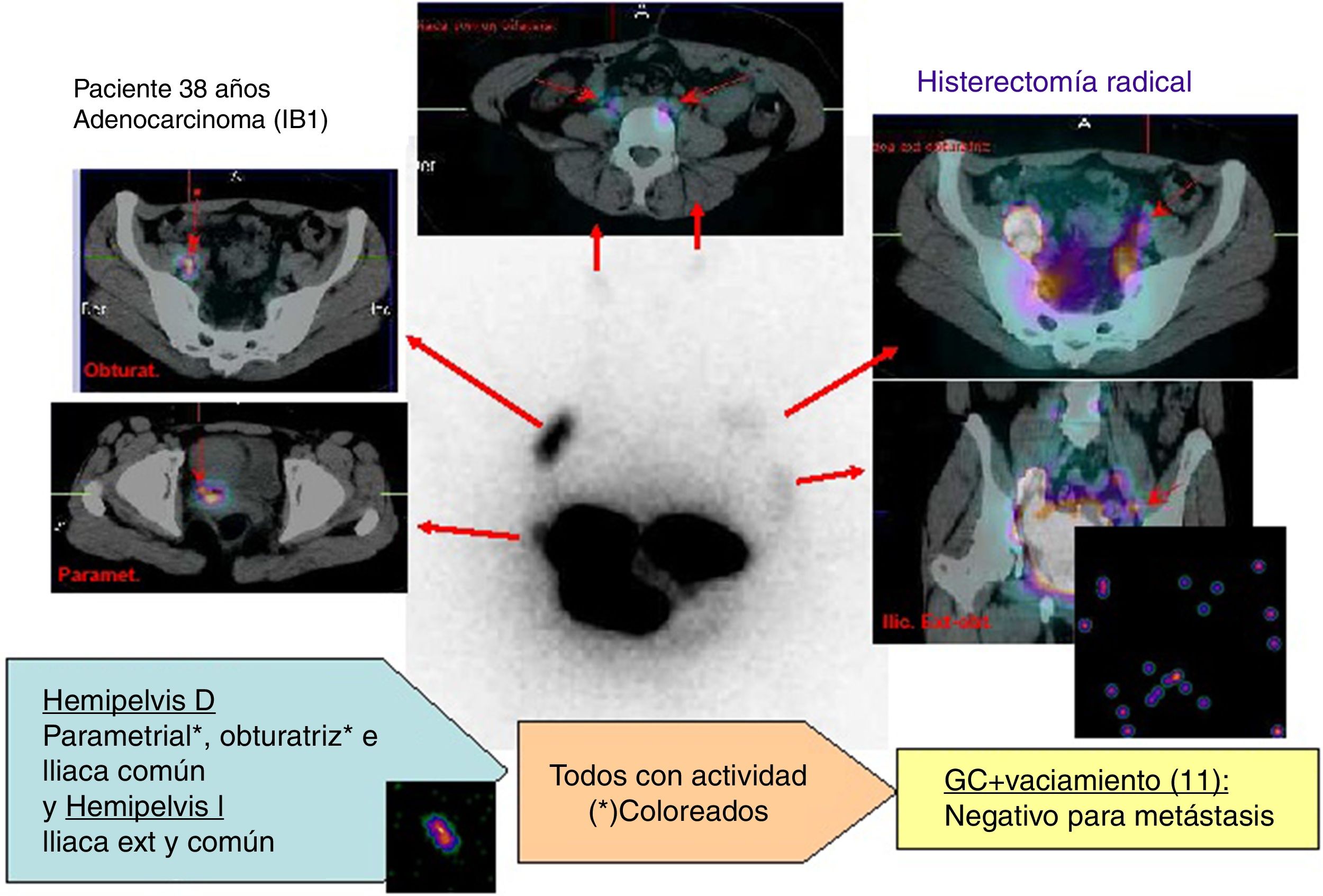 Biopsia selectiva del ganglio centinela en cáncer de cérvix ...