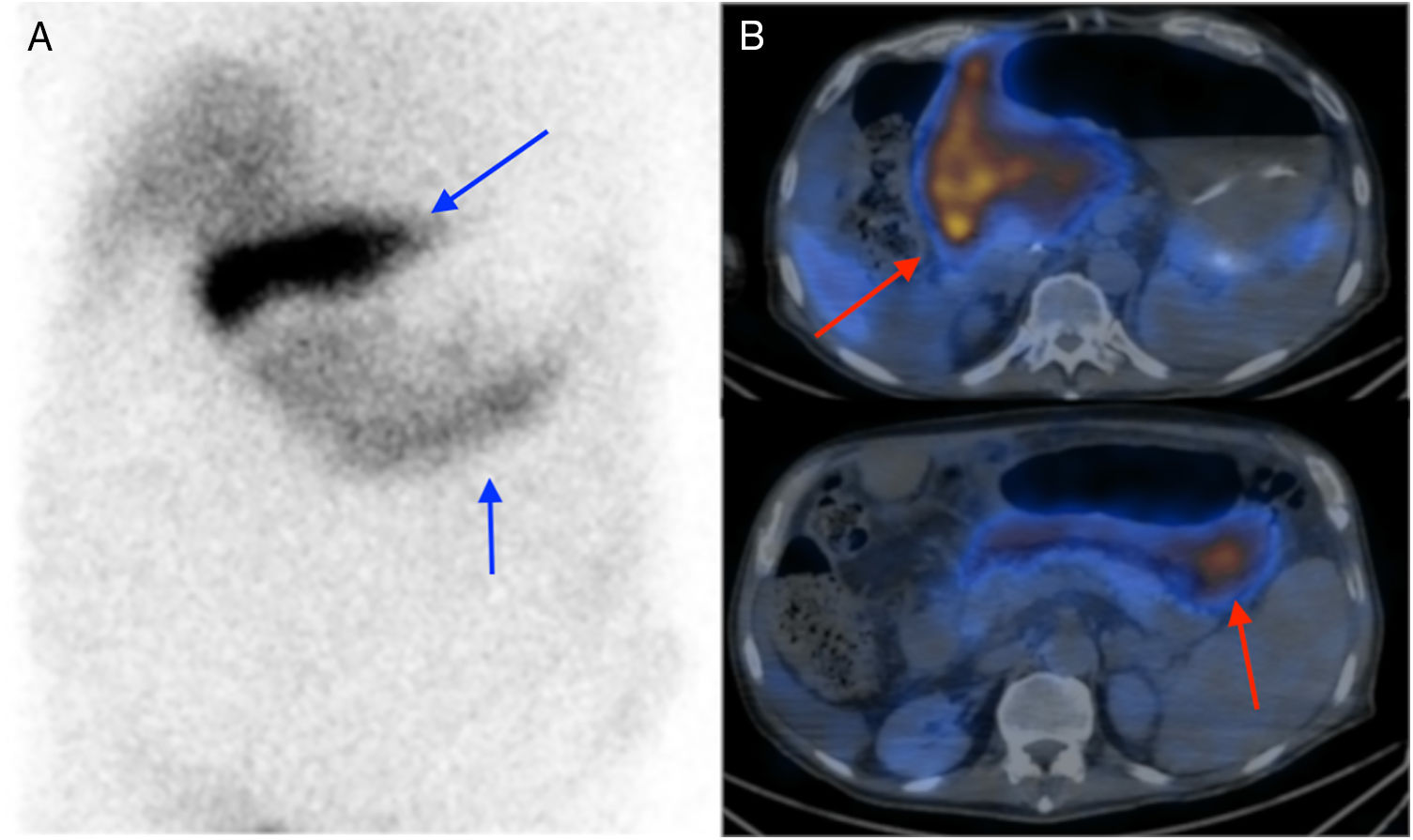 Gammagrafía hepatobiliar en el estudio de las complicaciones del ...