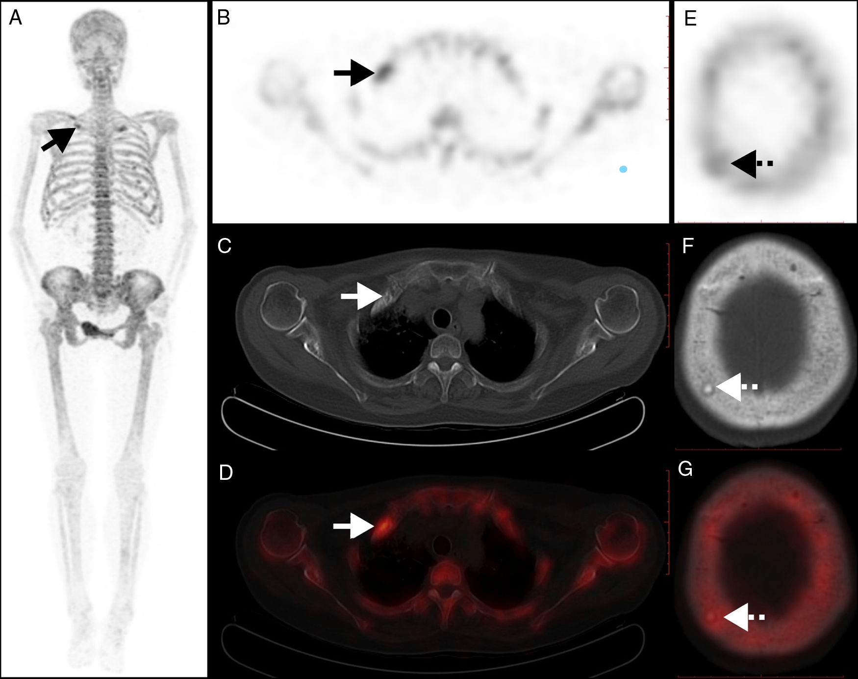 Detección de osteoma osteoide multicéntrico en hueso parietal y ...
