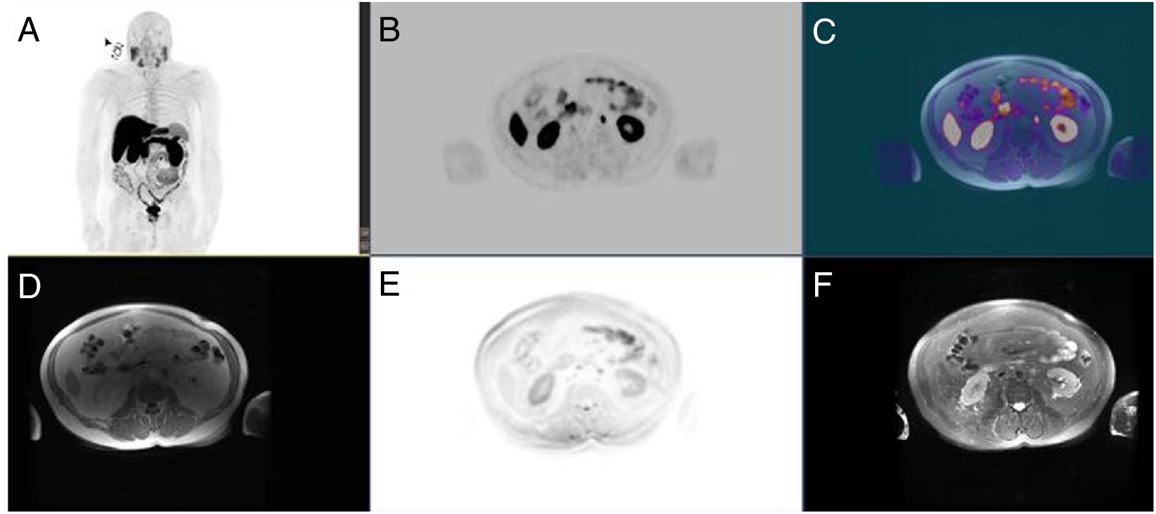 La PET/RM con 18F-colina en el diagnóstico inicial del cáncer de próstata. Impacto en la ...