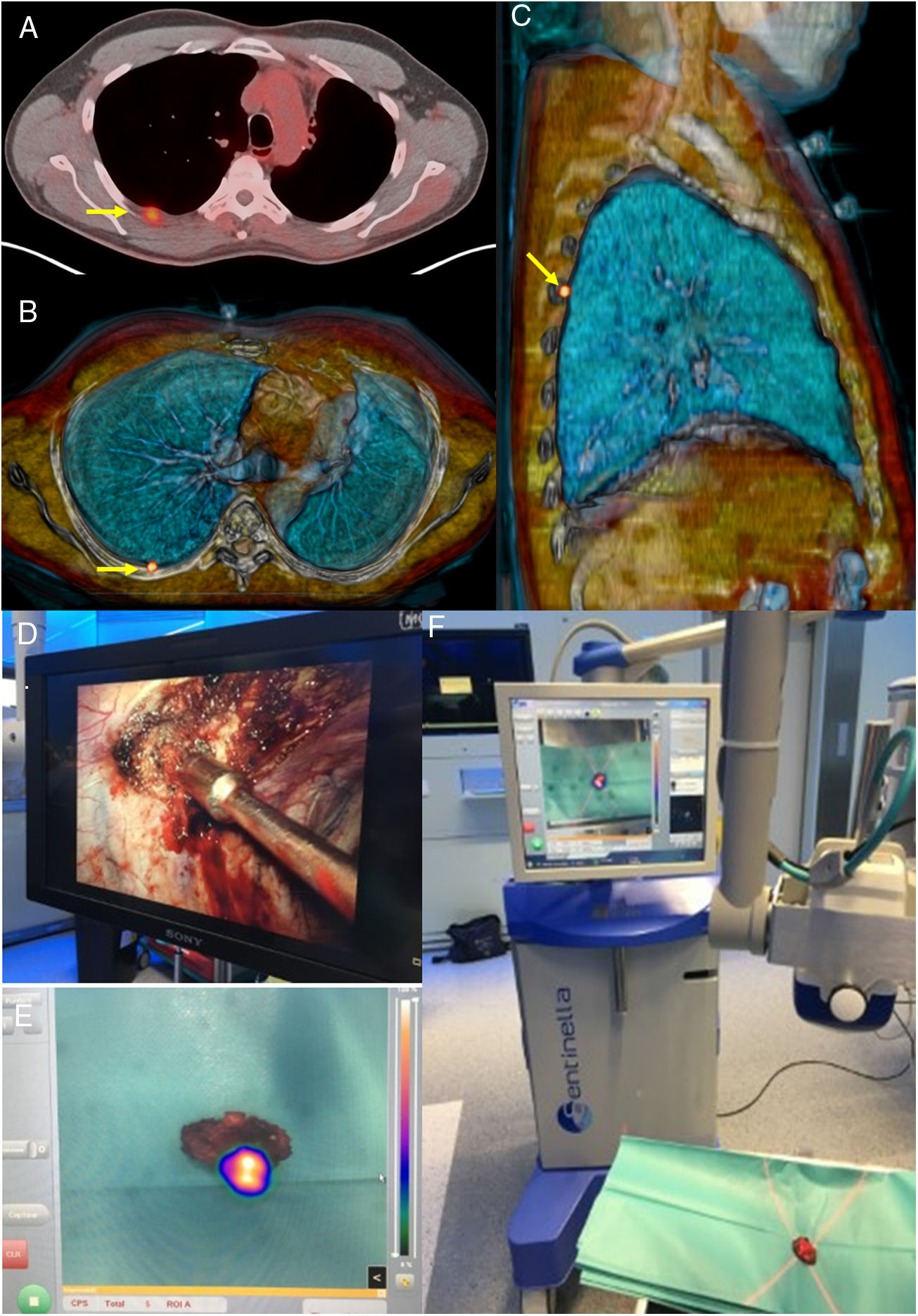 Biopsia pleural mediante técnica ROLL: primer caso en la literatura ...