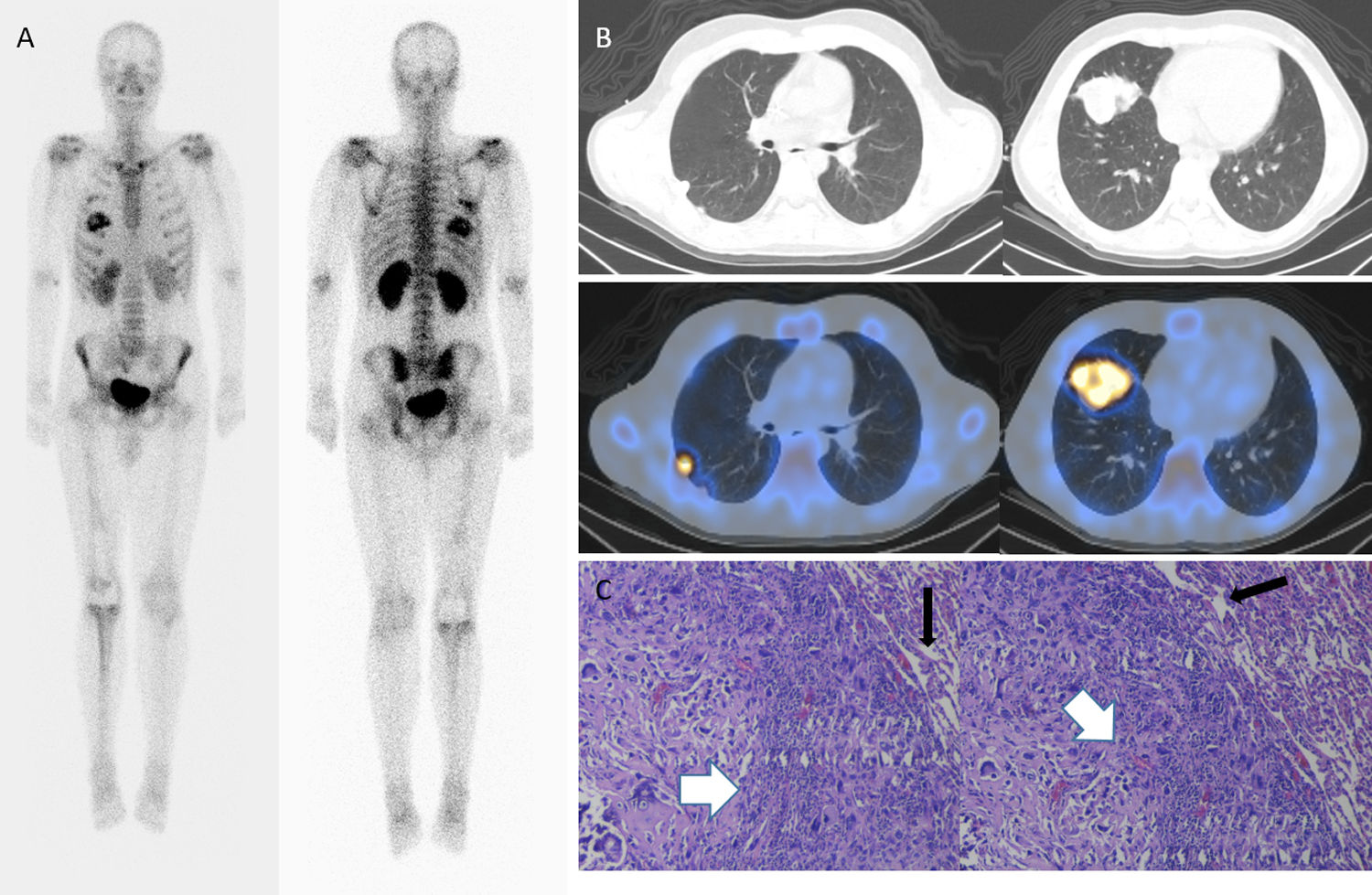 Identificación, mediante imagen 99mTc-HDP-SPECT/TC, de metástasis ...