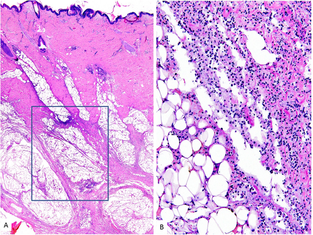 Hallazgo inesperado de gangrena de Fournier en la PET/TC con 18FDG de ...