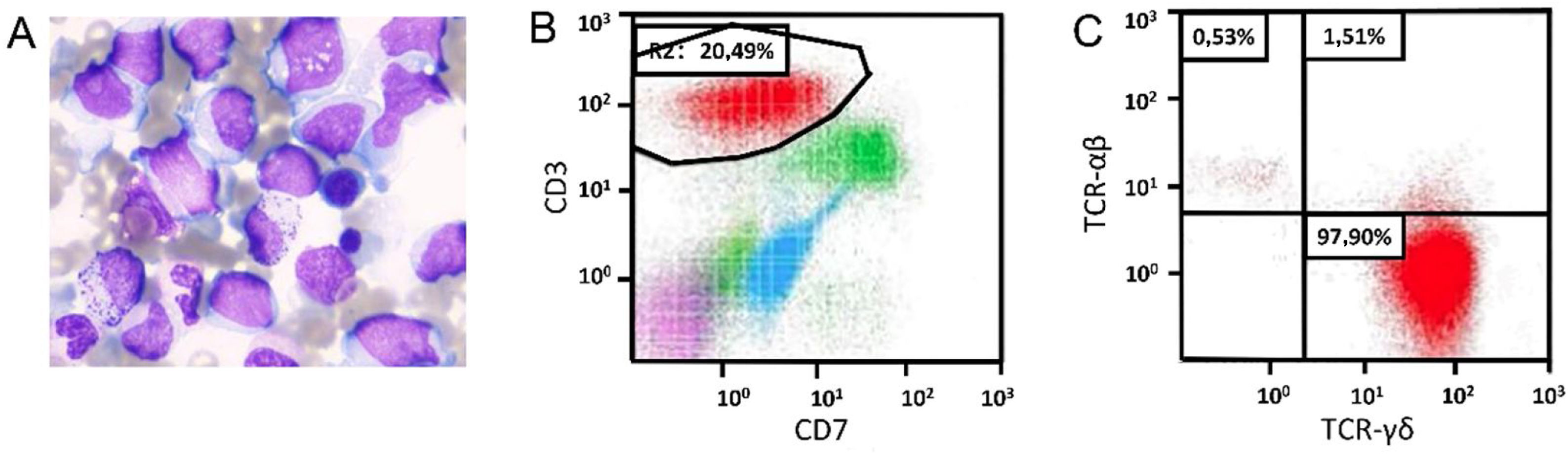 Linfoma hepatoesplénico raro de células T gamma-delta detectada por18F ...