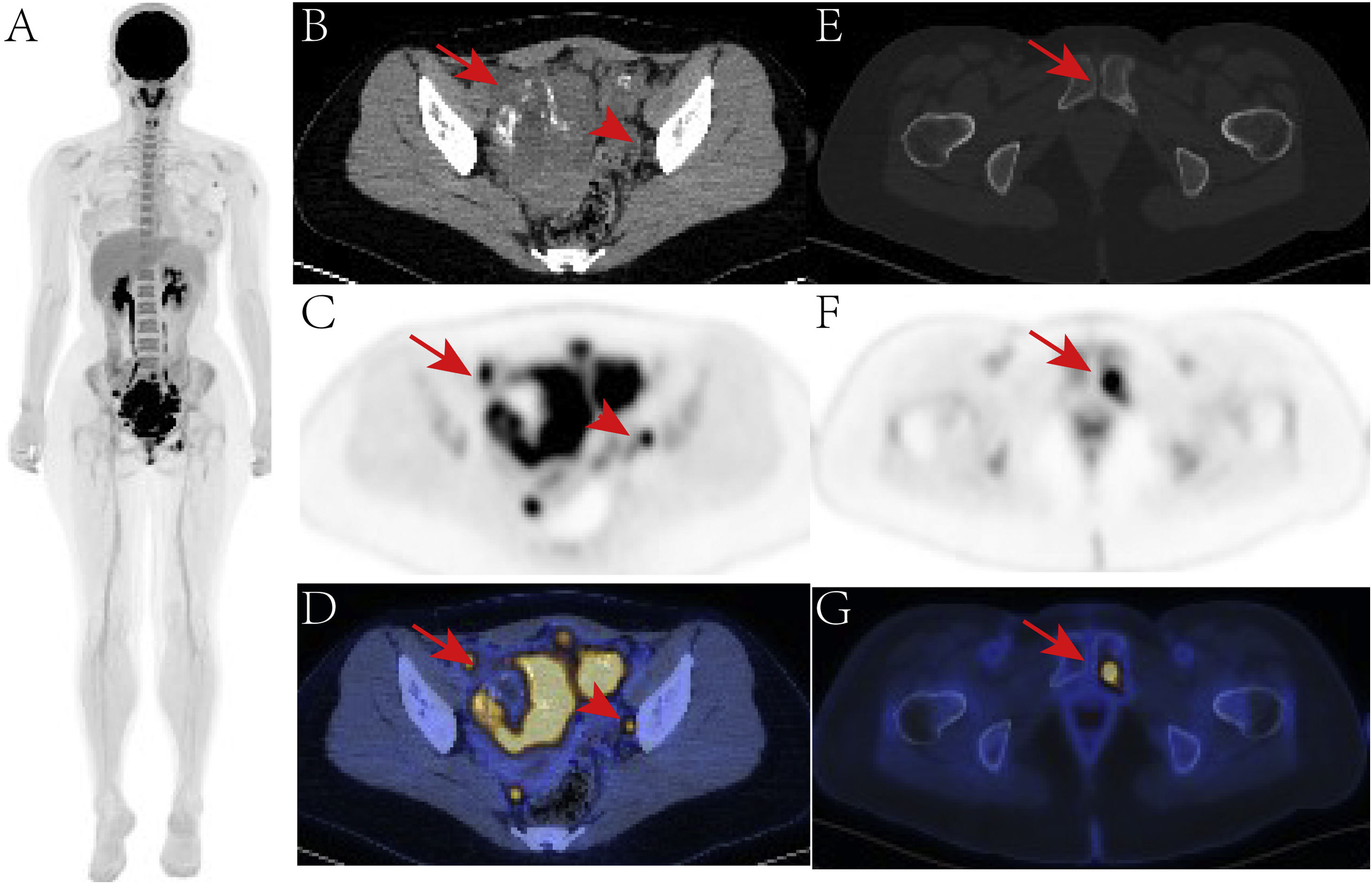 Tumor desmoplásico de células redondas pequeñas con afectación ovárica ...