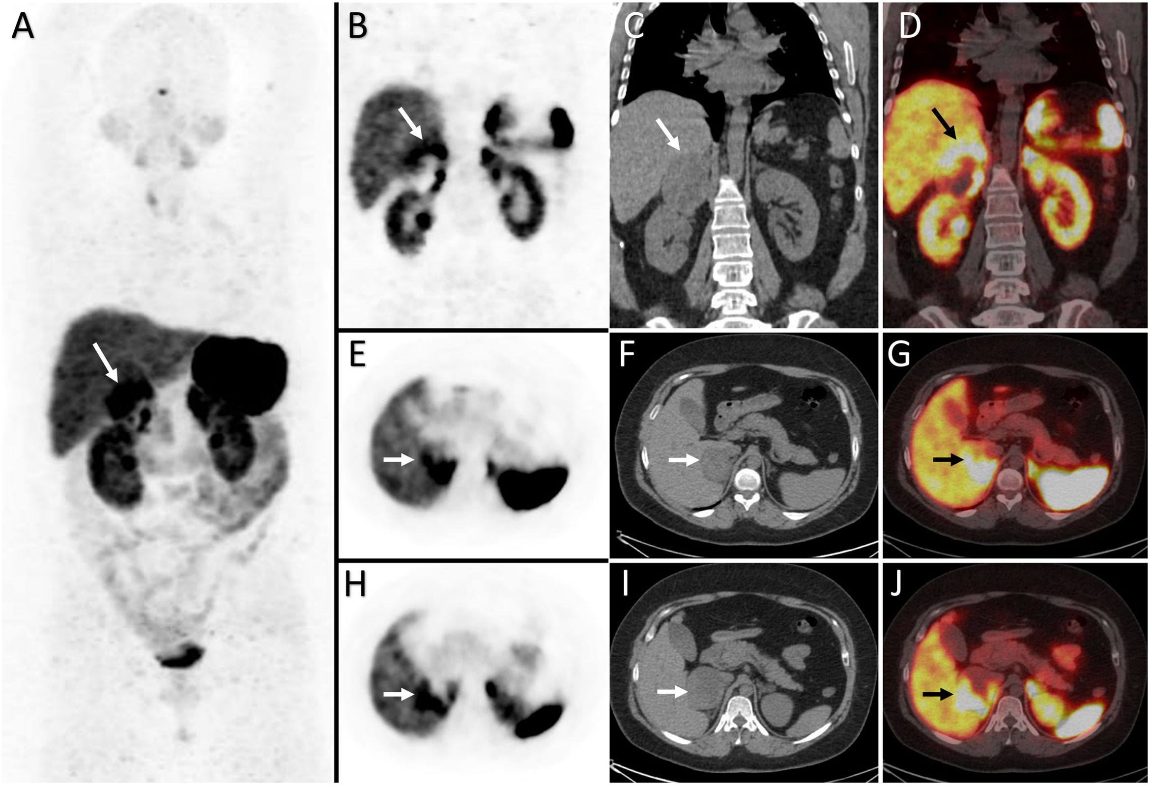 Metástasis suprarrenal solitaria de cáncer de mama en PET/TC con [68Ga ...