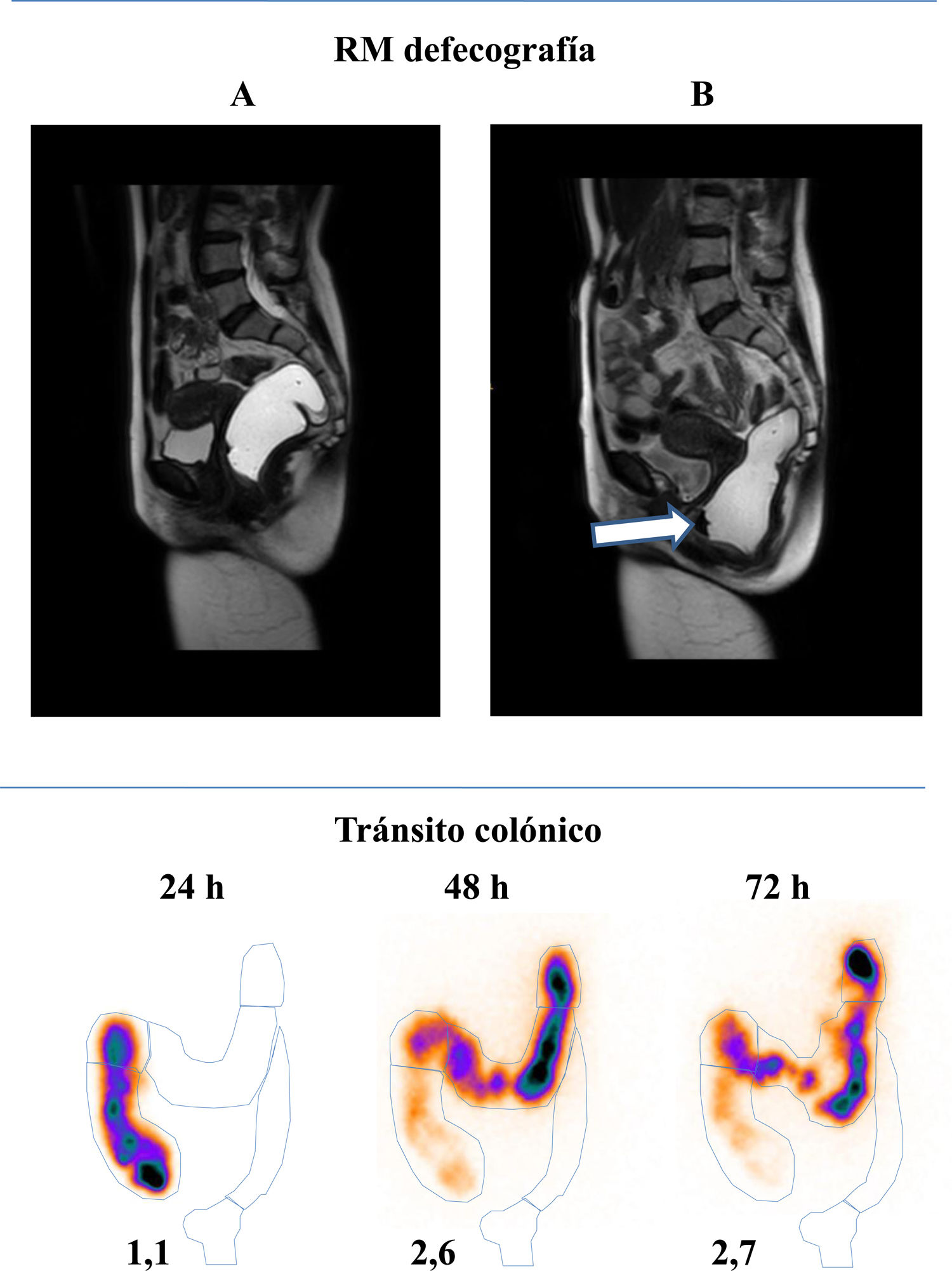 Gammagrafía de tránsito gastrointestinal en la valoración del rectocele ...