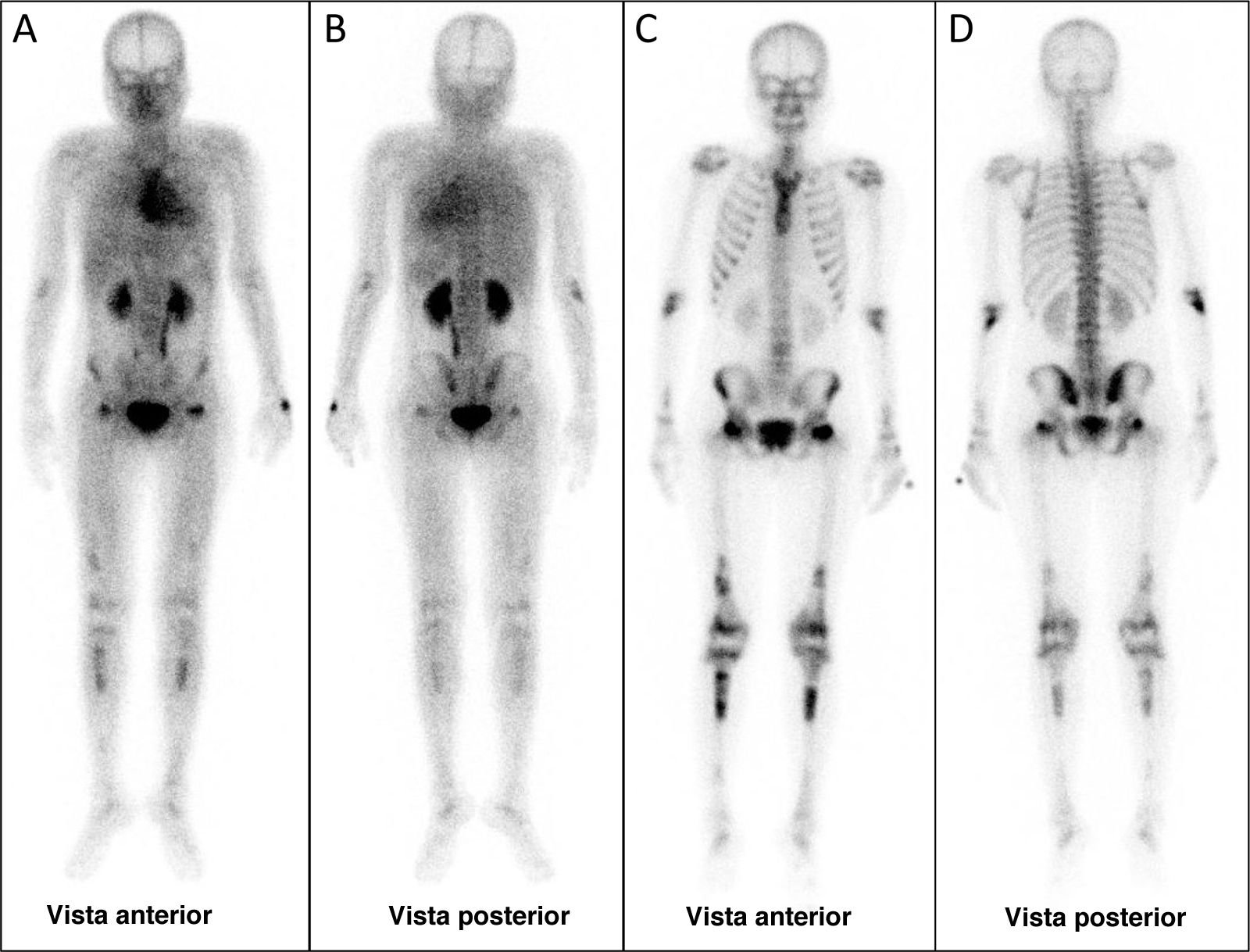 Osteonecrosis multifocal en lupus eritematoso sistémico de inicio ...