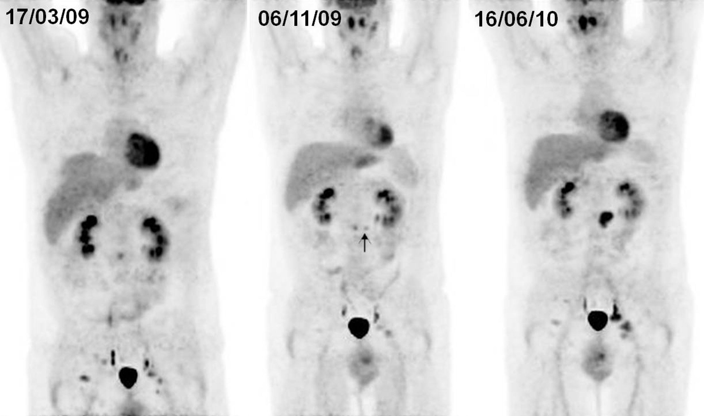 18F-FDG-PET/CT in the surveillance of patients with lymphoma: Detection ...