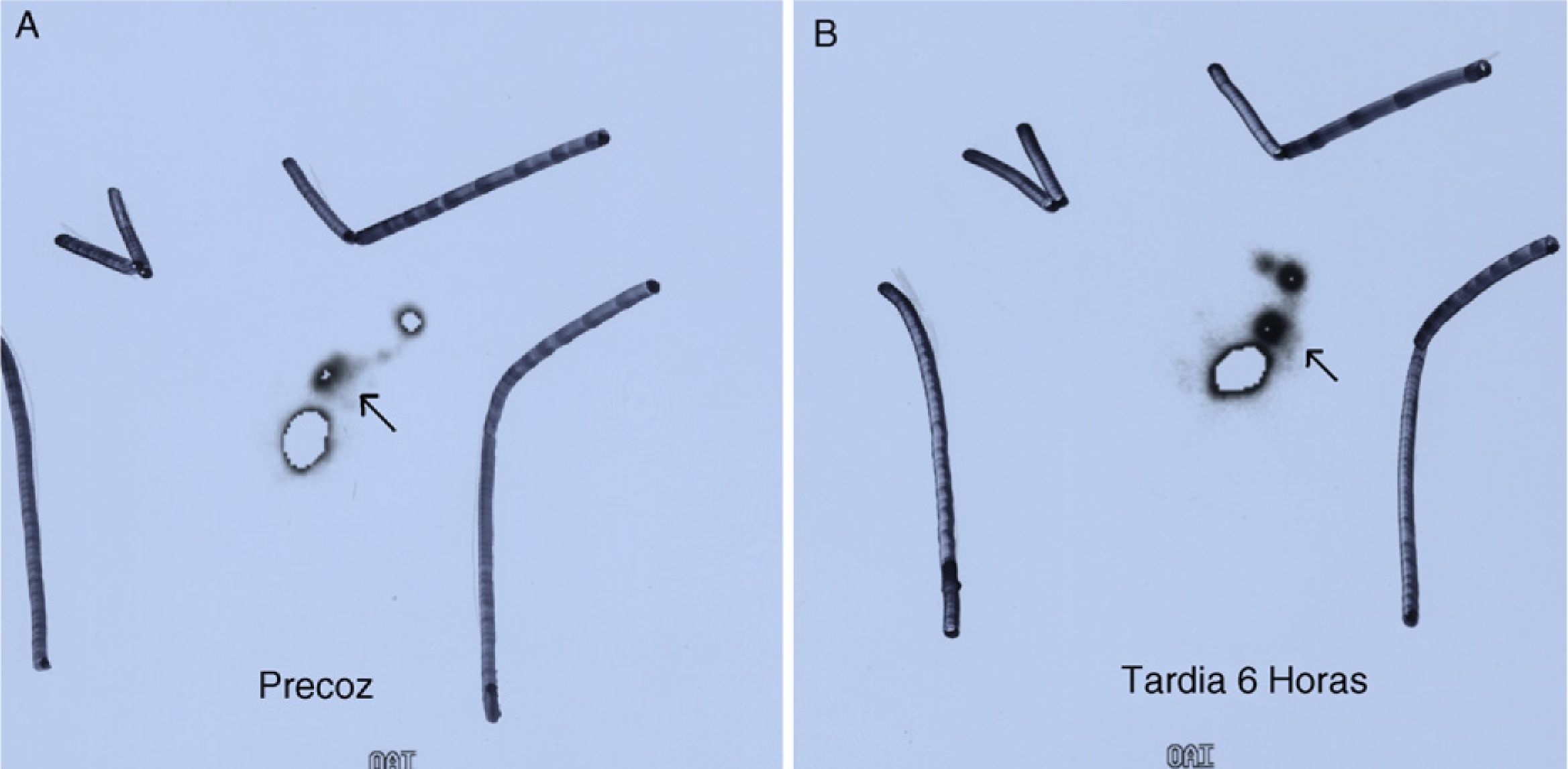 False positive of intramammary sentinel lymph node in ...