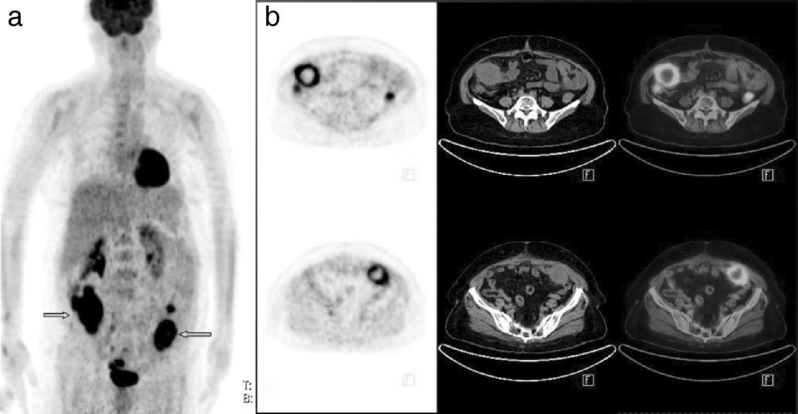 The value of FDG-PET/CT in the post-treatment evaluation of endometrial carcinoma: A comparison ...