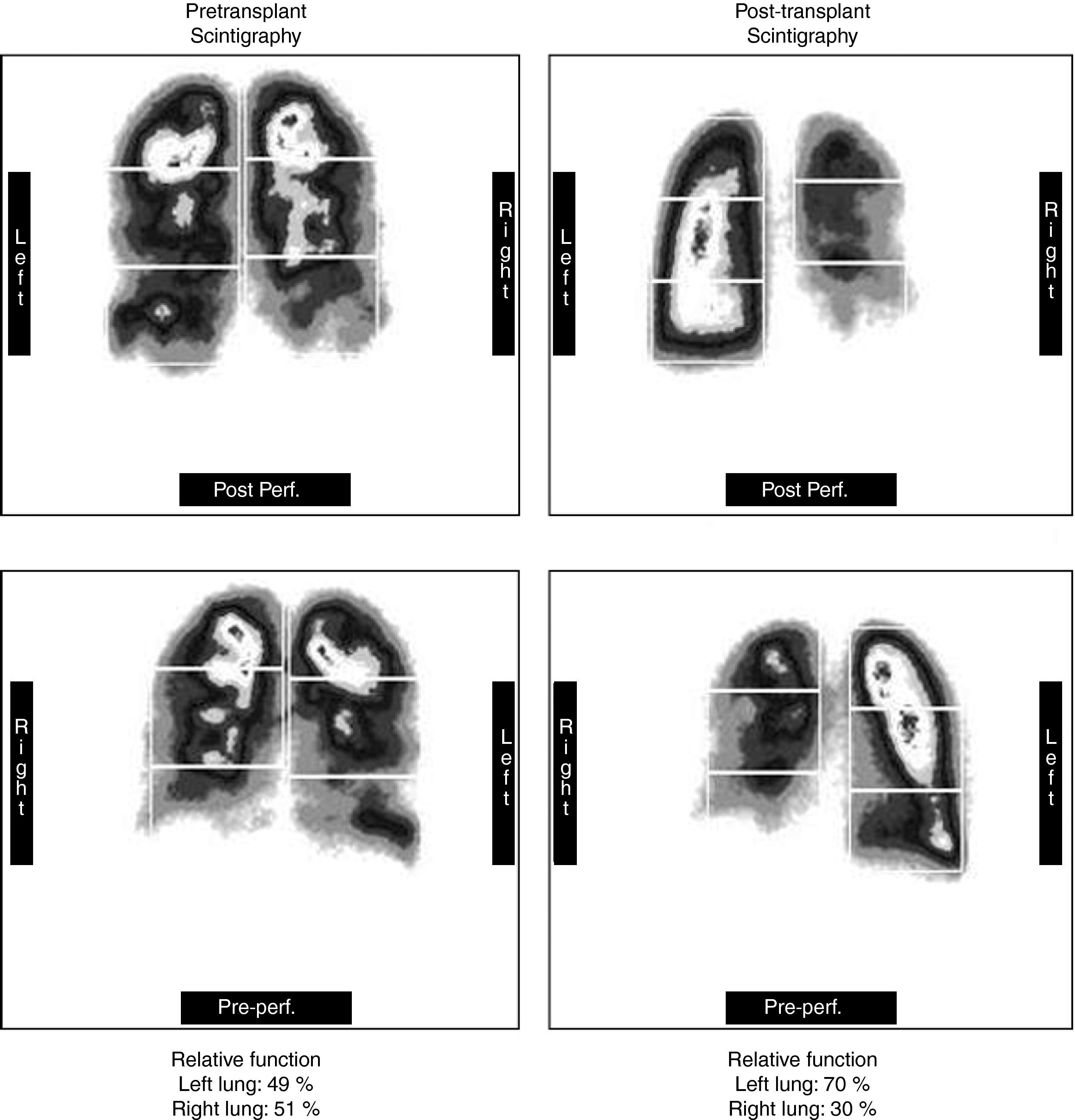 Importance of lung perfusion scintigraphy in single lung ...