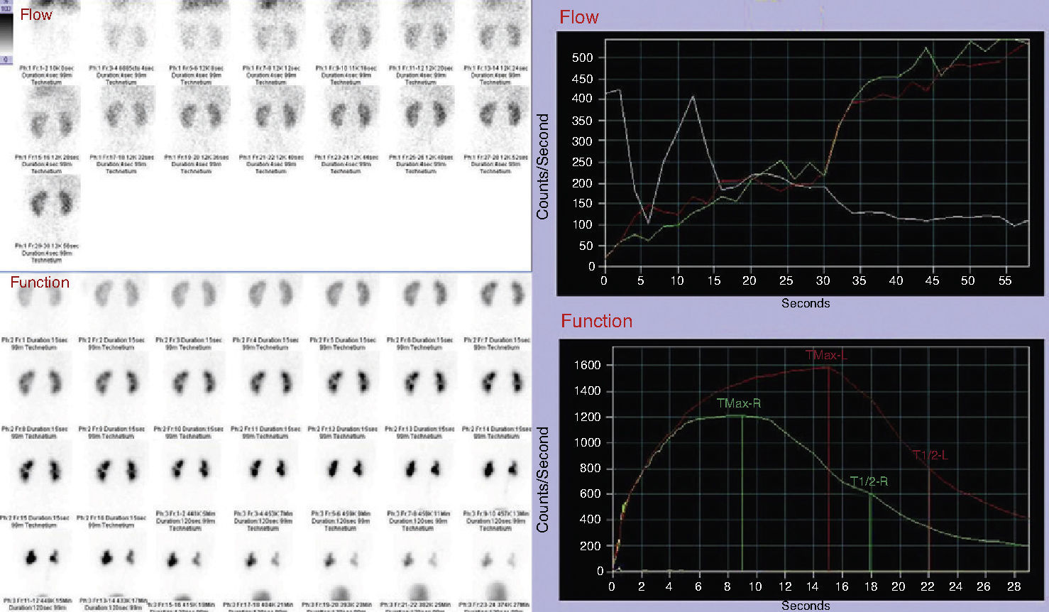 Monitoring of renal function using 99mTc-DMSA and 99mTc-DTPA ...